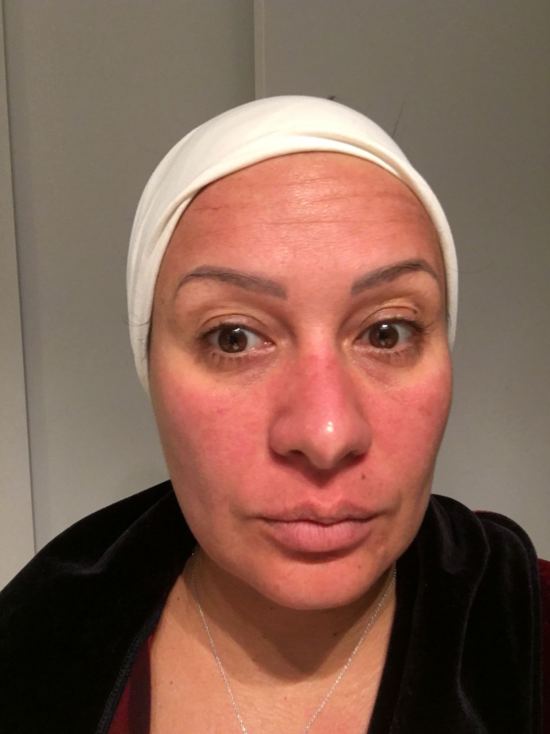 Adverse reactions - Beauty Insider Community
