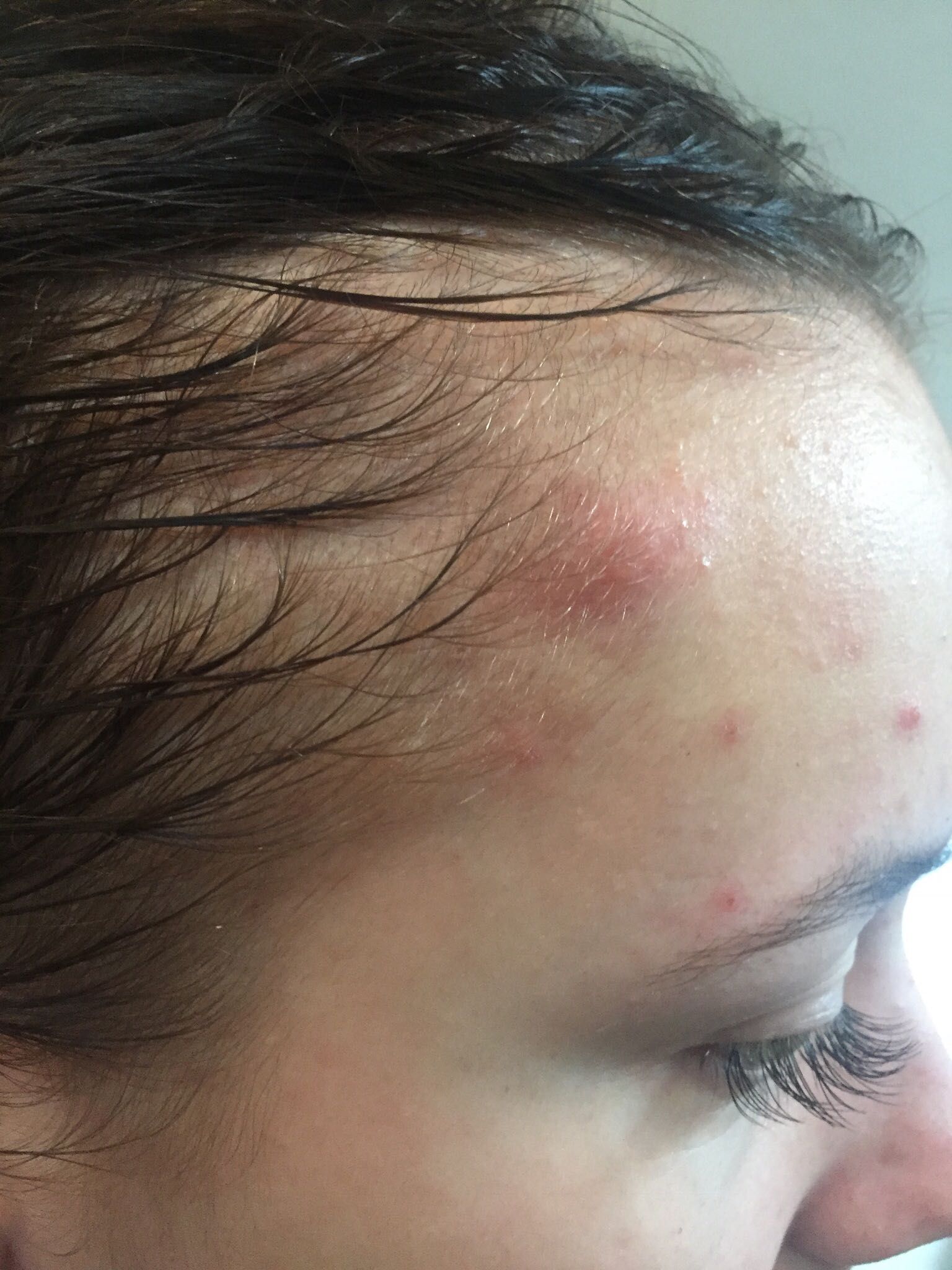 Cystic Acne/clogged pores - Beauty Insider Community