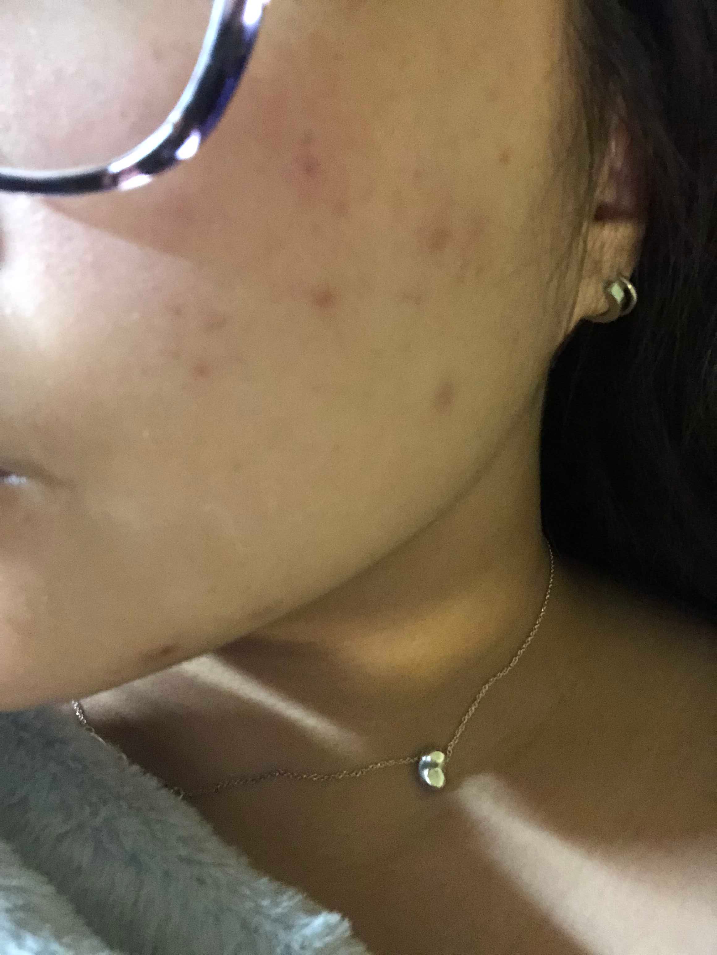 Bad breakouts and worse spots! Any recom... - Beauty Insider Community