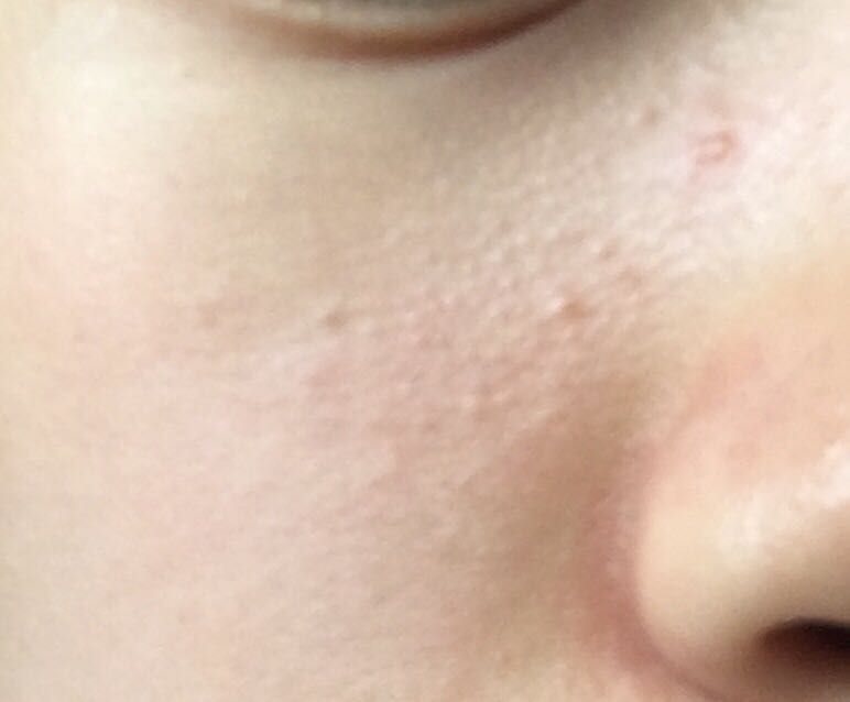 bumpy/textured skin?? - Beauty Insider Community