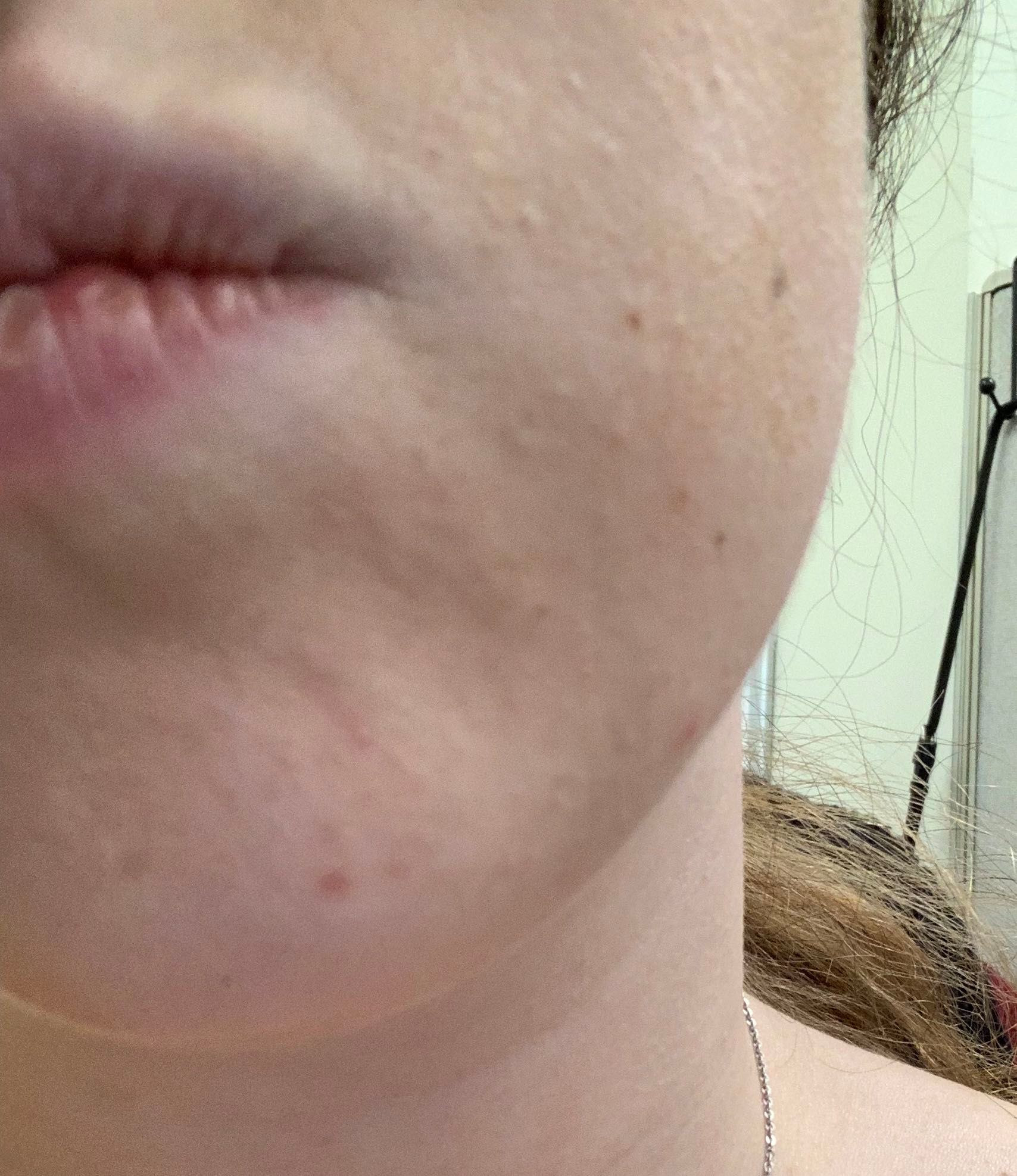 How to get rid of tiny zit-like bumps on... - Beauty Insider Community