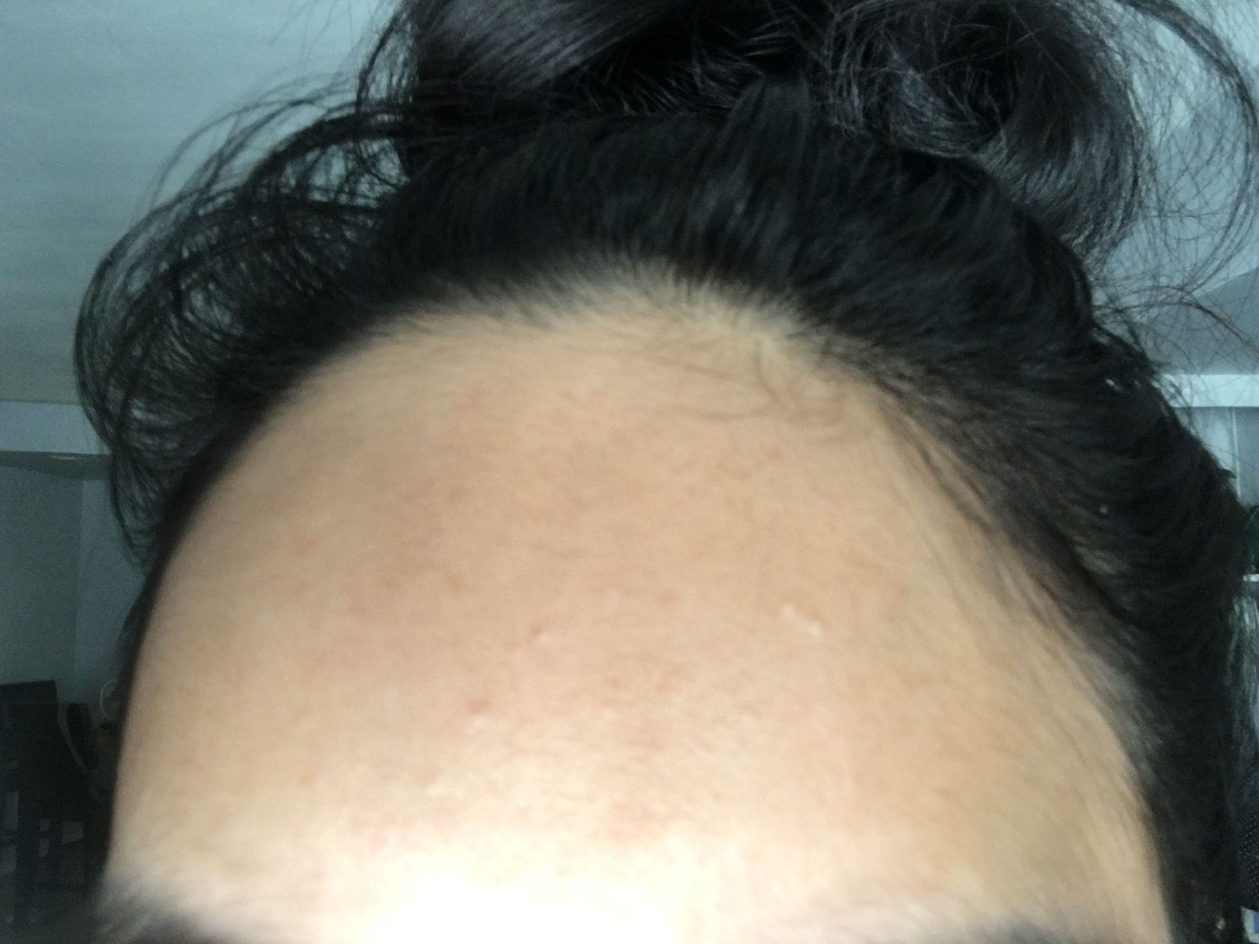 Colorless bumps on forehead, cheeks and ... - Beauty Insider Community