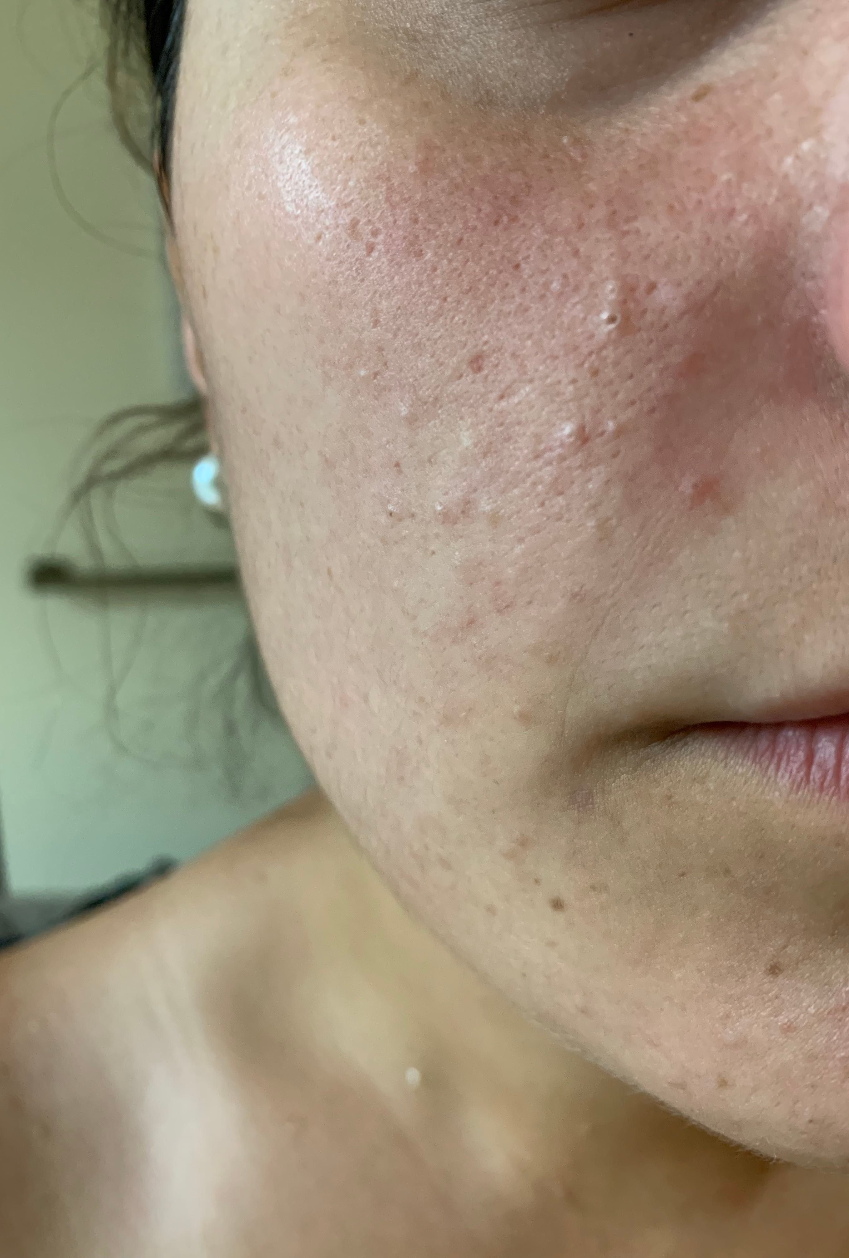 Bumpy Texture On Face