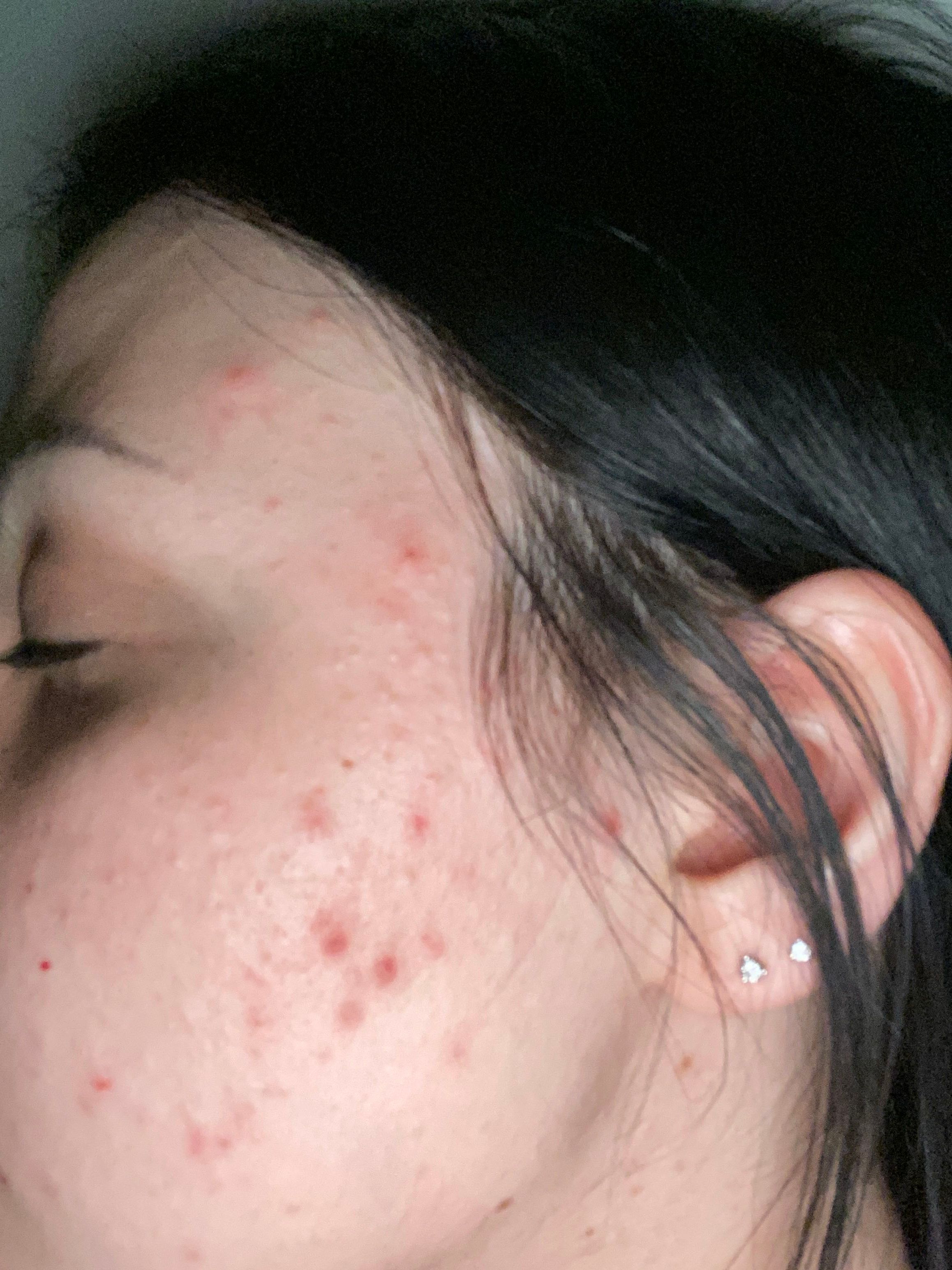 Face breakout disaster!!! - Beauty Insider Community