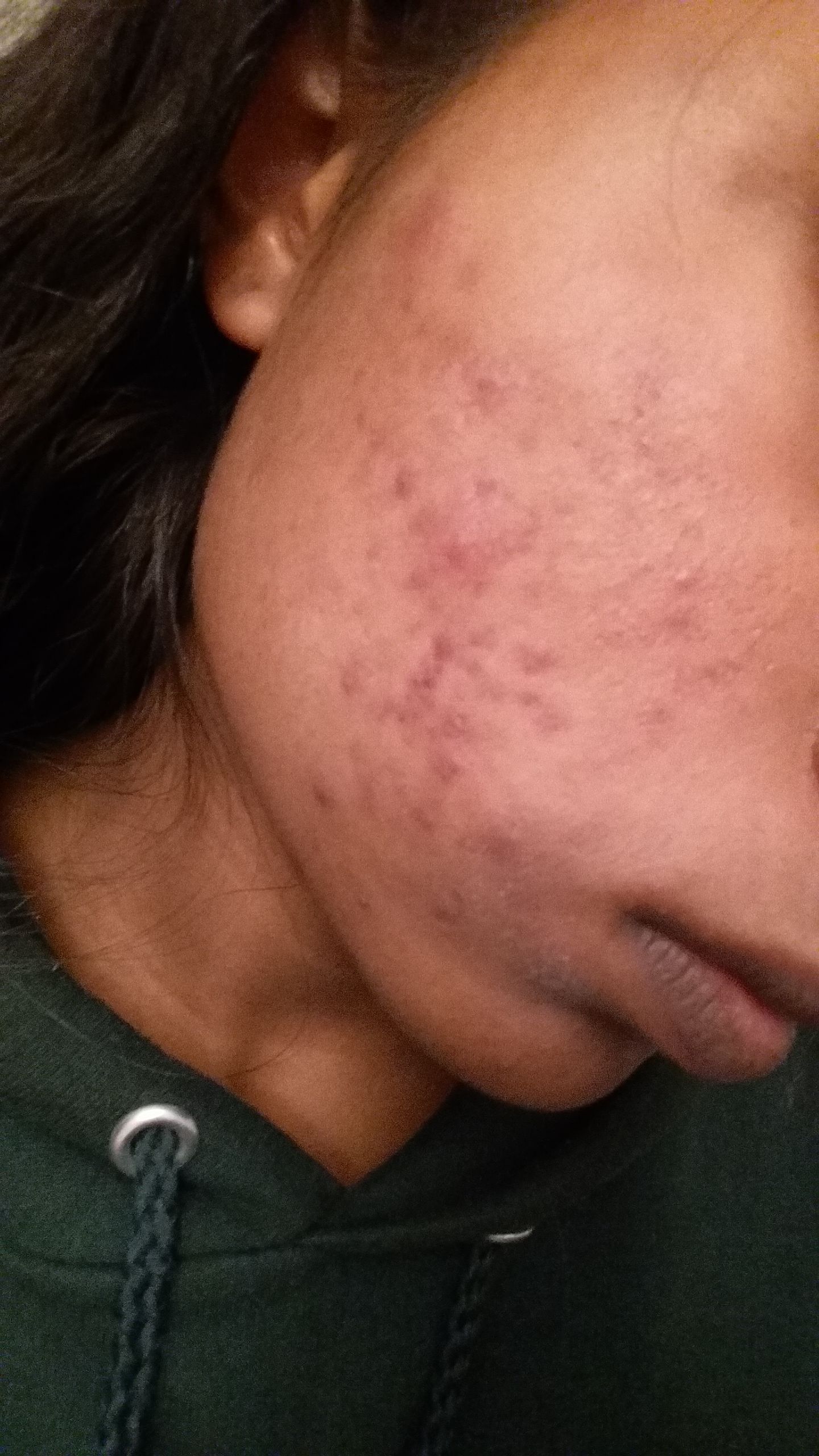 Acne Scars and Hyperpigmentation - Beauty Insider Community