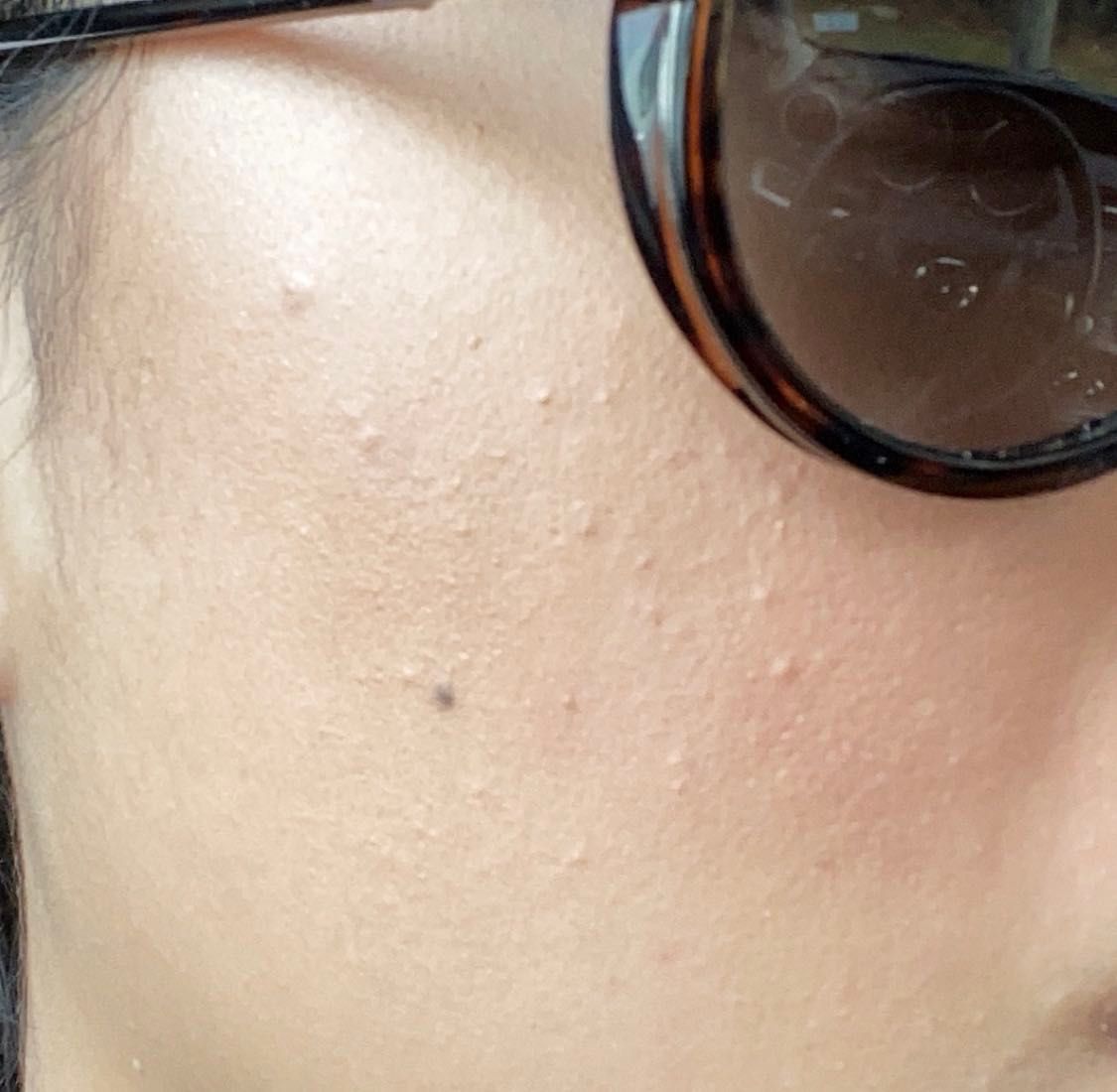 Tiny bumps on cheeks - Beauty Insider Community