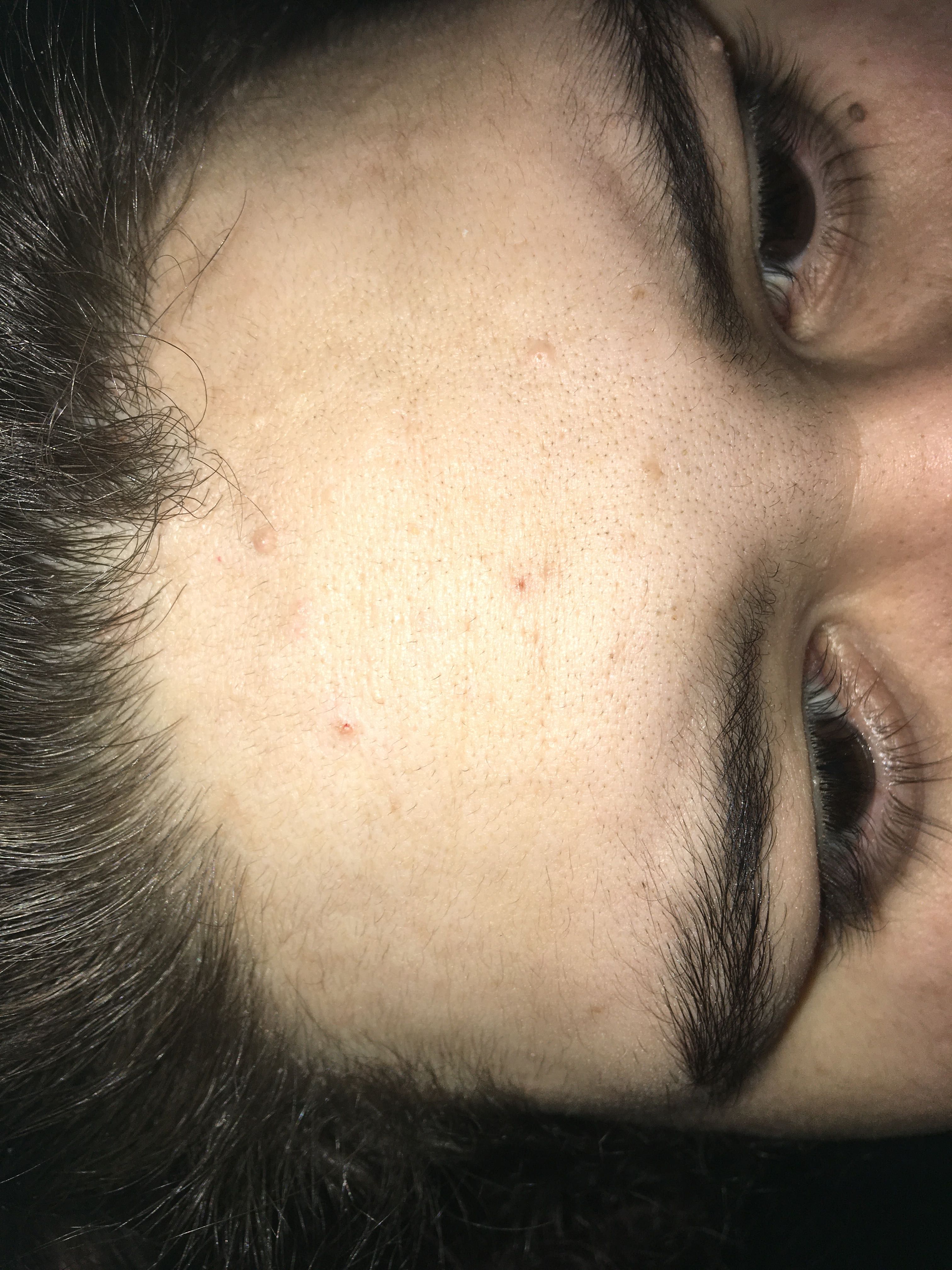 Colorless bumps on forehead kinda small ... - Beauty Insider Community