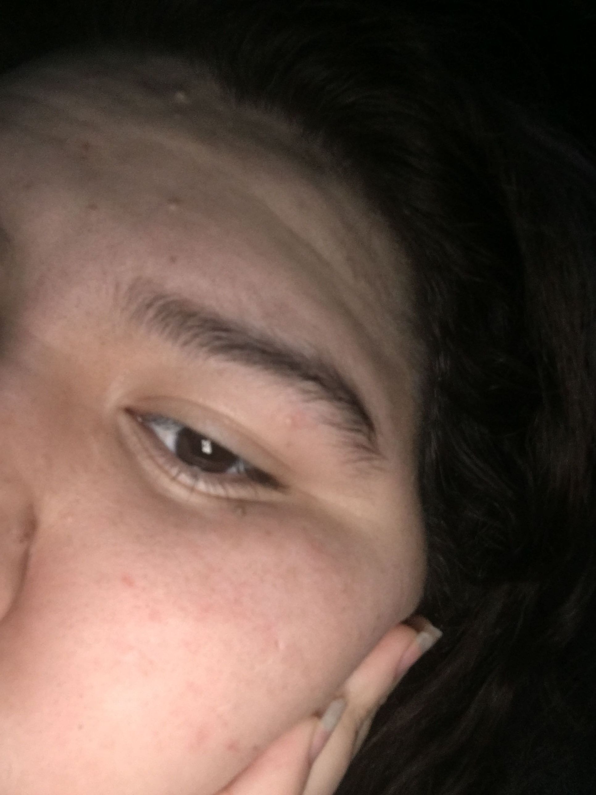 Colorless bumps on forehead kinda small ... - Beauty Insider Community