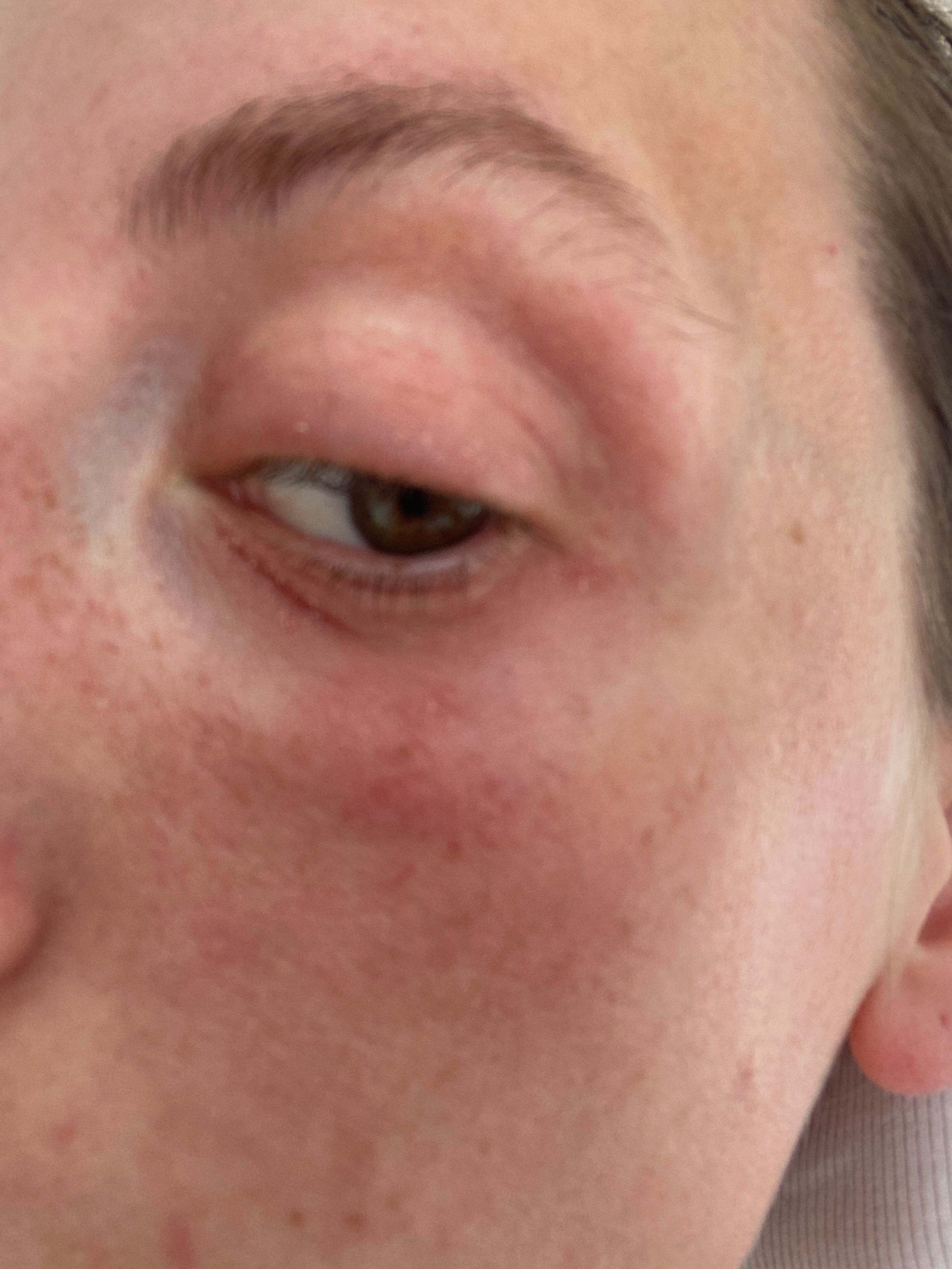 Contact Dermatitis Eyes