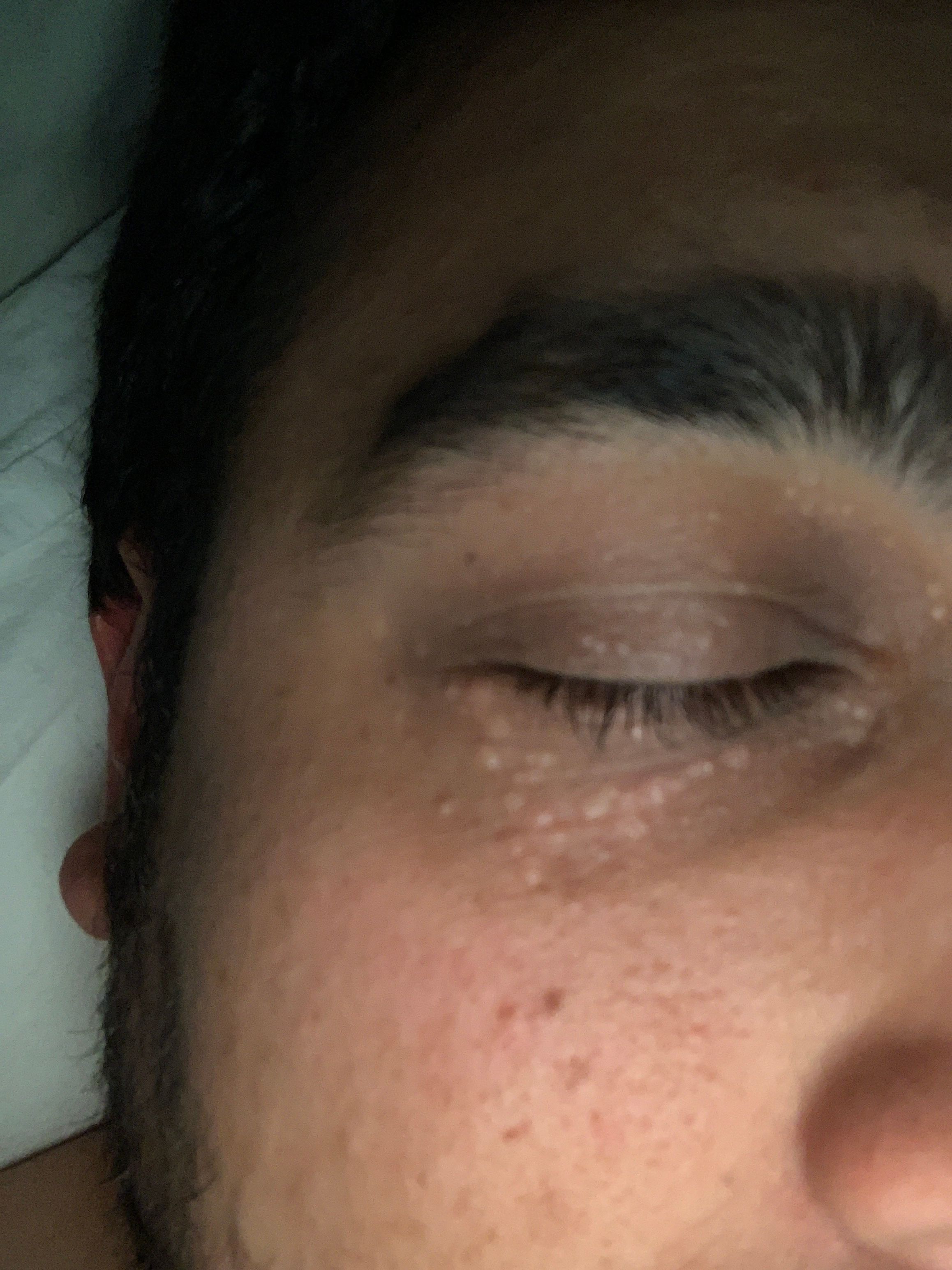 Keratosis Pilaris Under Eyes