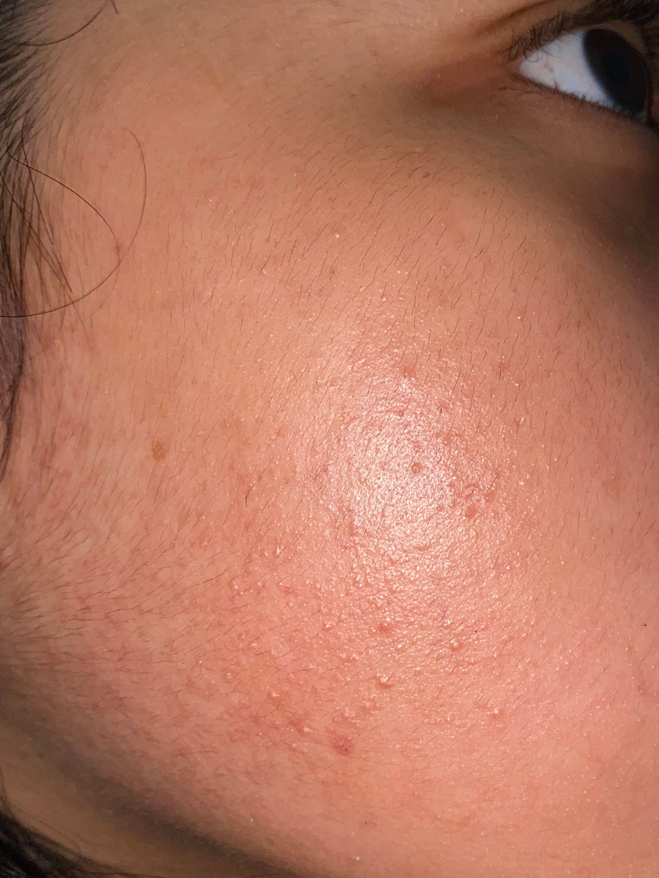small bumps on my cheeks, - Beauty Insider Community
