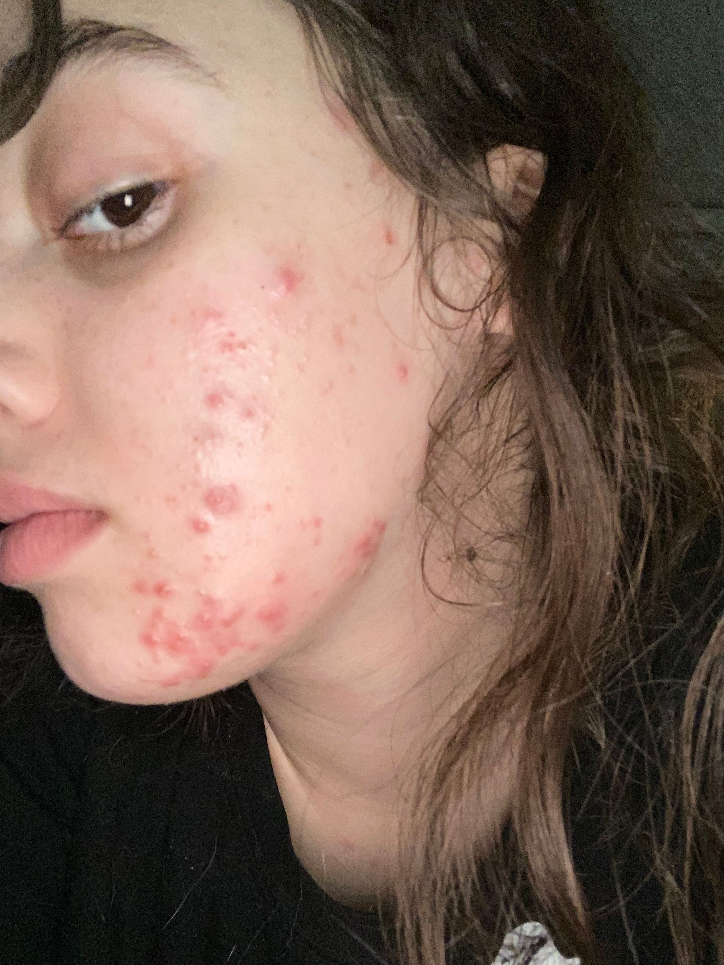 Cystic Acne (my first outbreak EVER HELP... - Beauty Insider Community