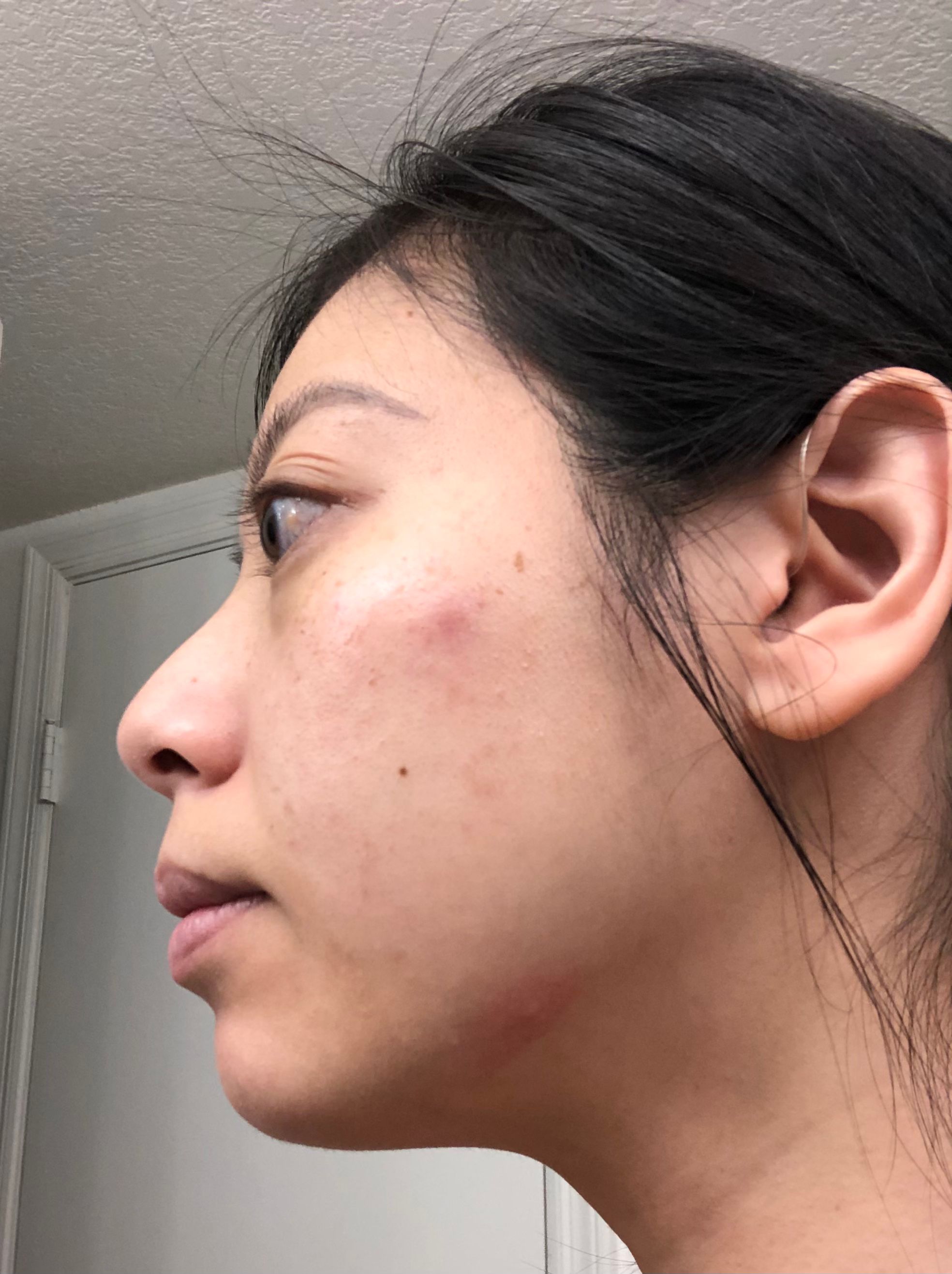 Itchy red face - Beauty Insider Community