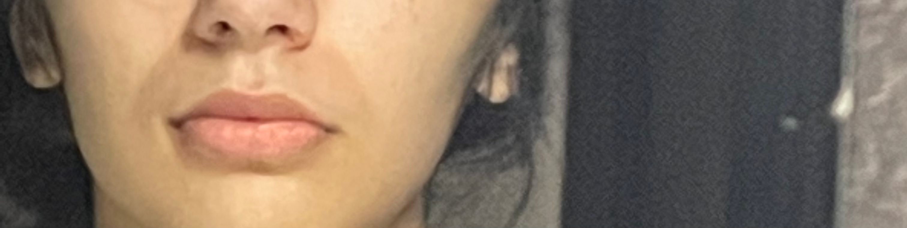 Hyperpigmentation around smile lines? He... - Beauty Insider Community