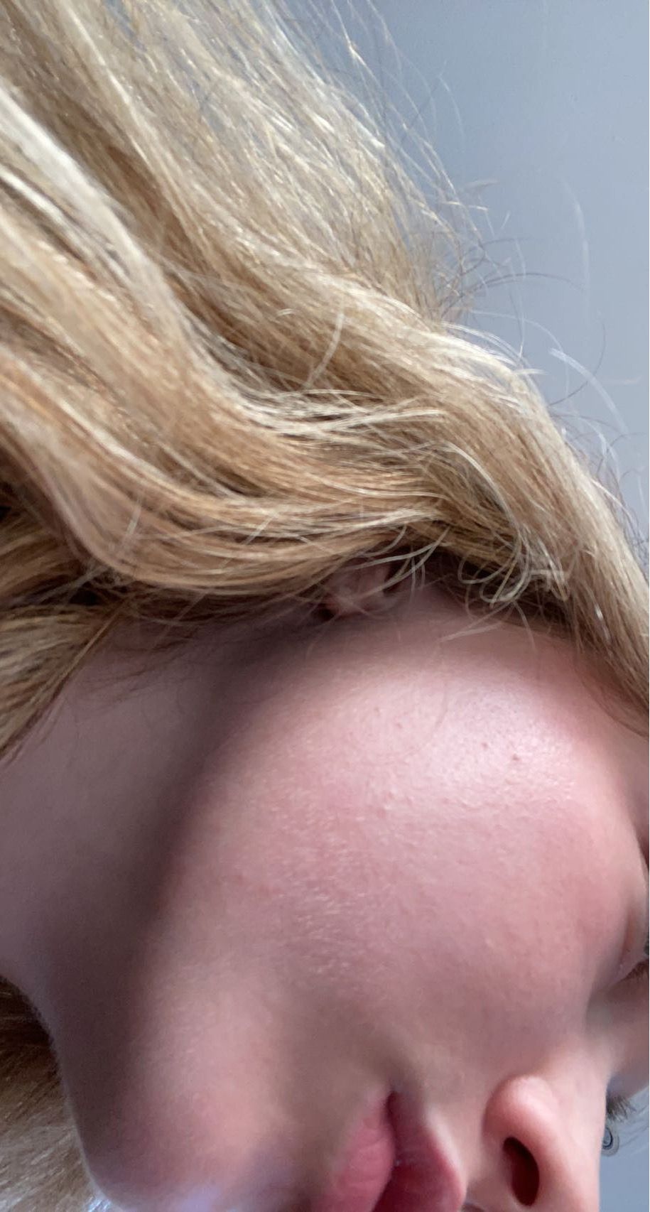 Bumpy texture on cheeks - Beauty Insider Community