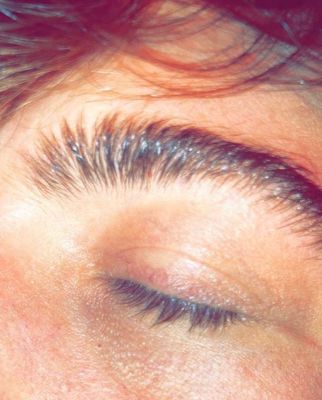 Chicken skin under eyes - Beauty Insider Community