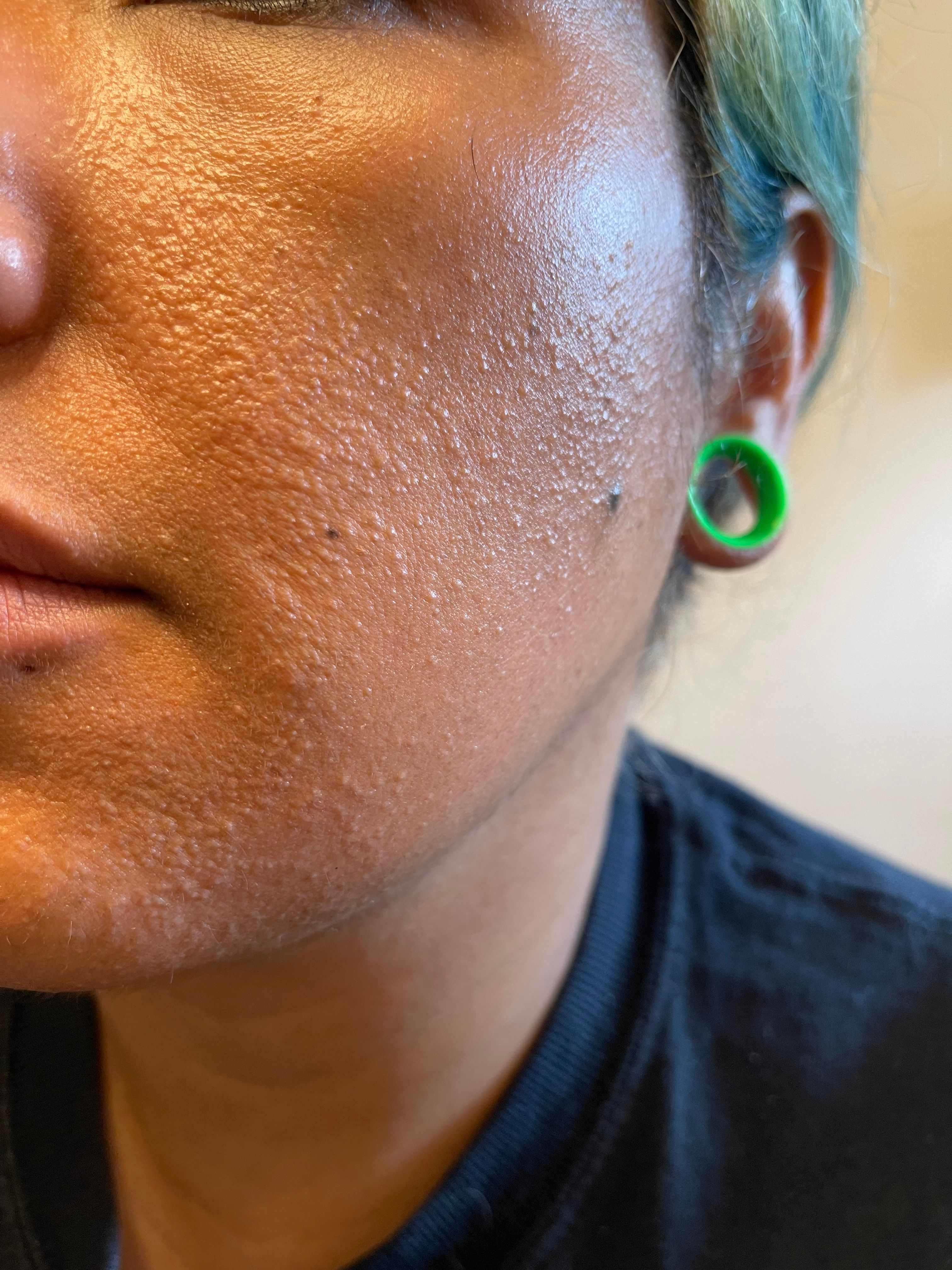 Small rash like bumps all over face - Beauty Insider Community