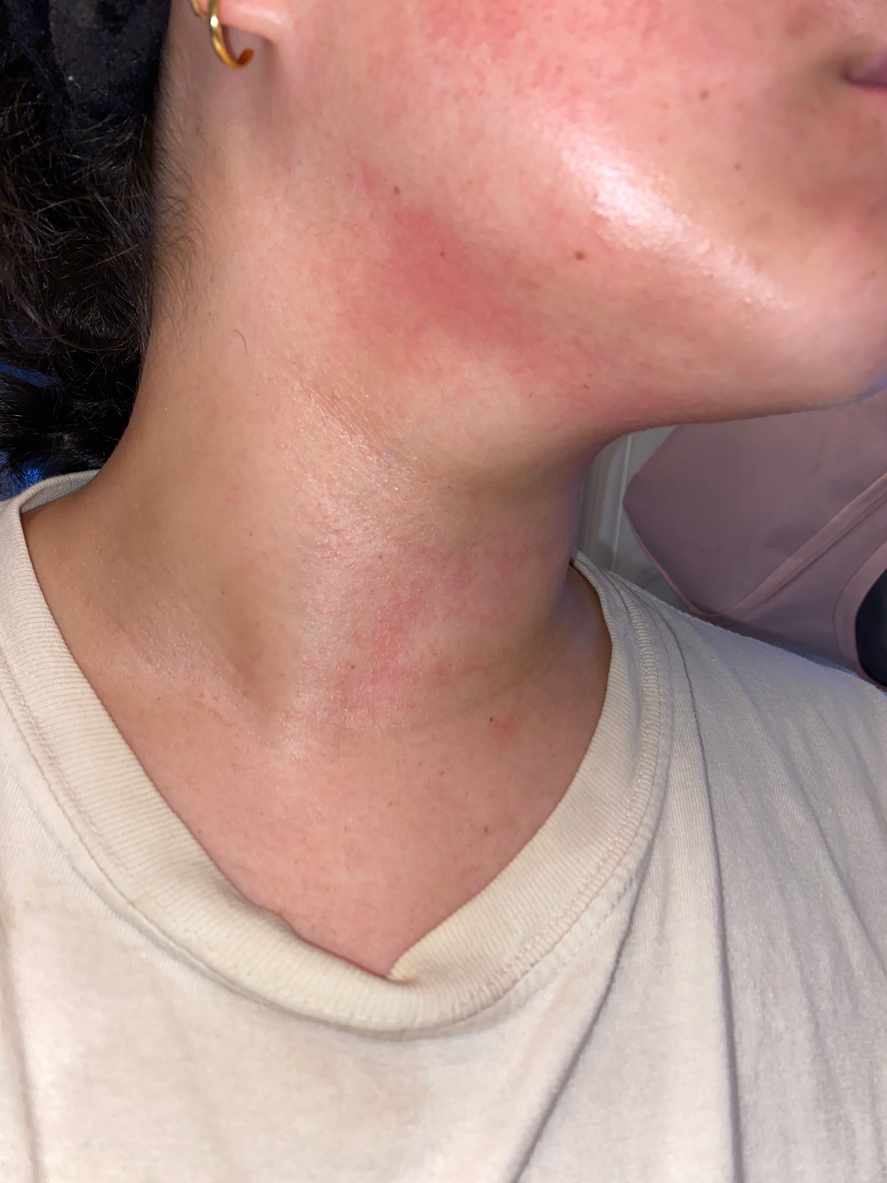Tiny fluid filled bumps all over face an... - Beauty Insider Community