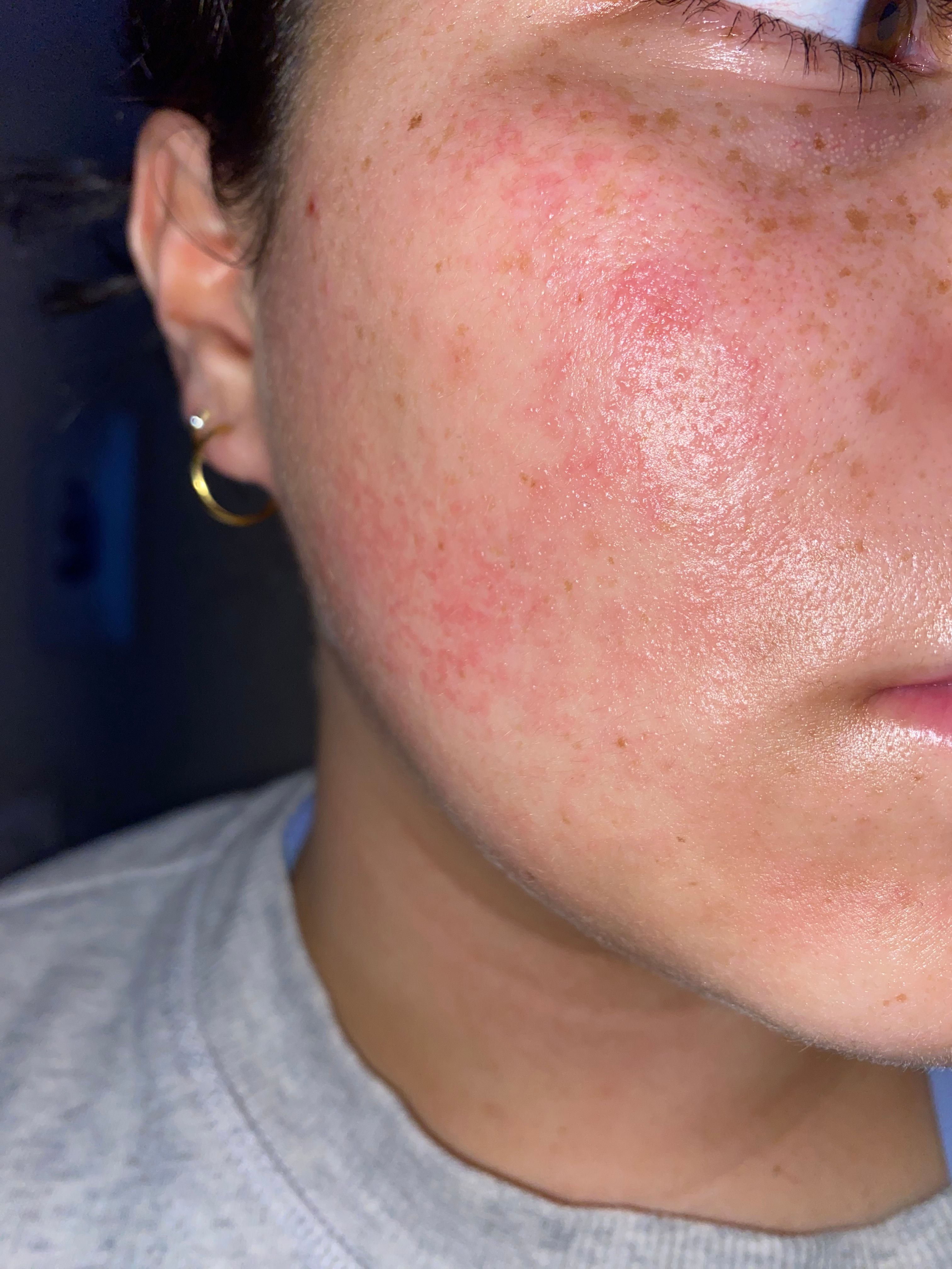 Tiny fluid filled bumps all over face an... - Beauty Insider Community