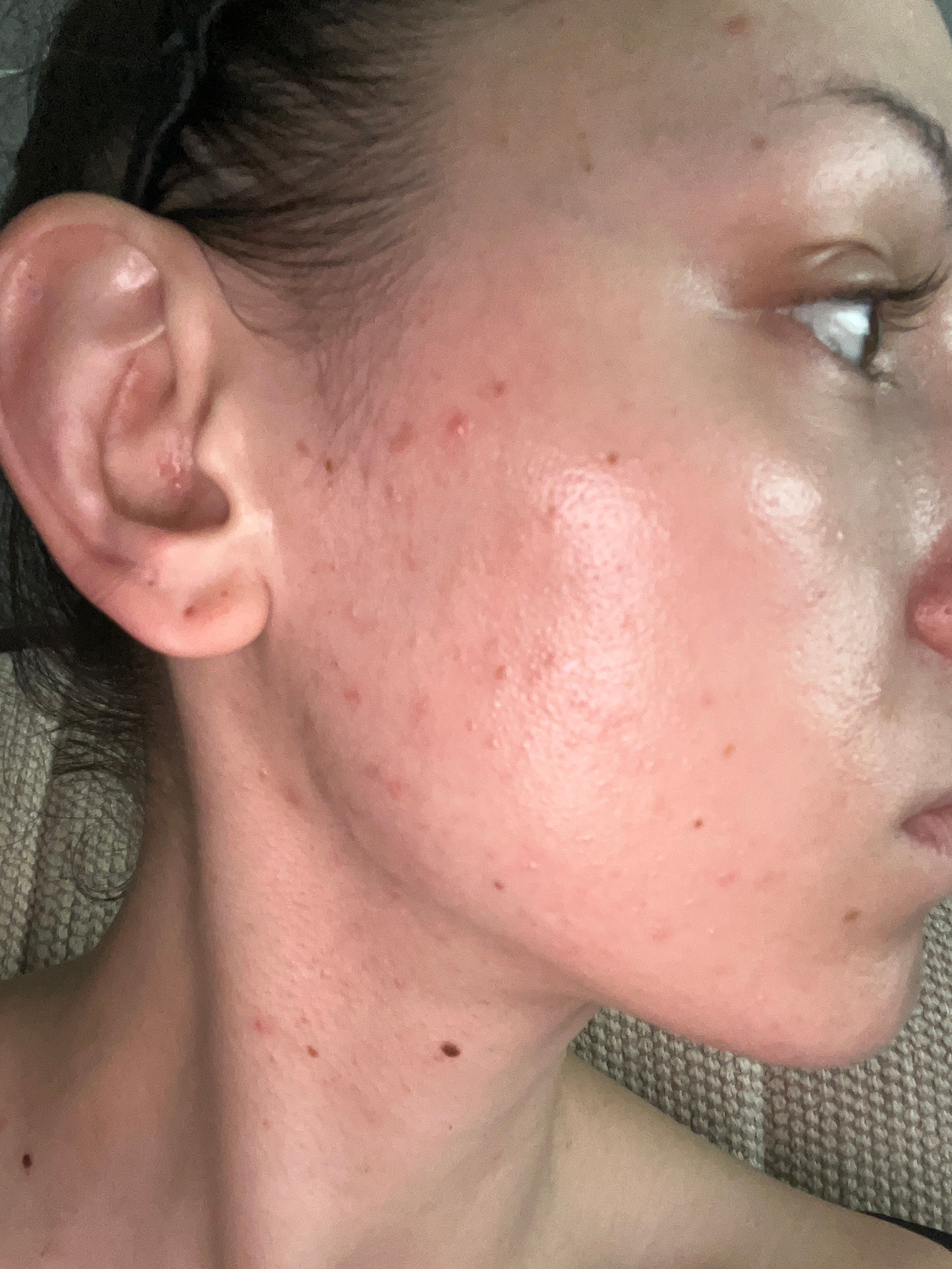 Is this fungal acne or closed comedowns? - Beauty Insider Community