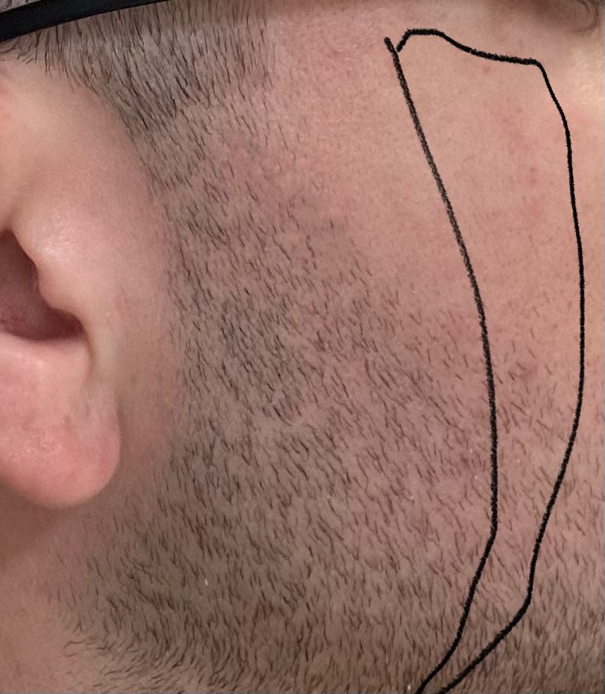 Red faint line on cheek - Beauty Insider Community