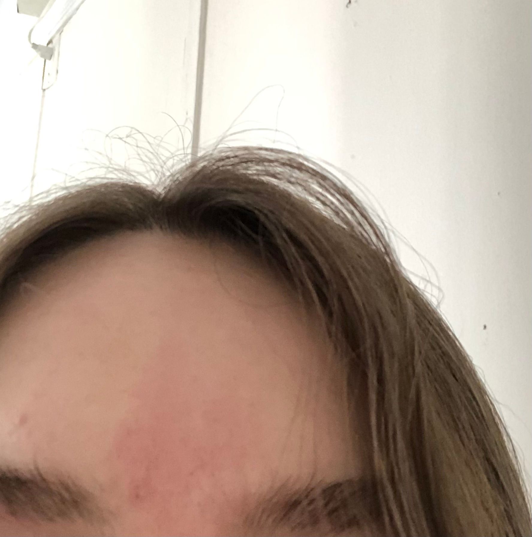 redness in tzone - Beauty Insider Community