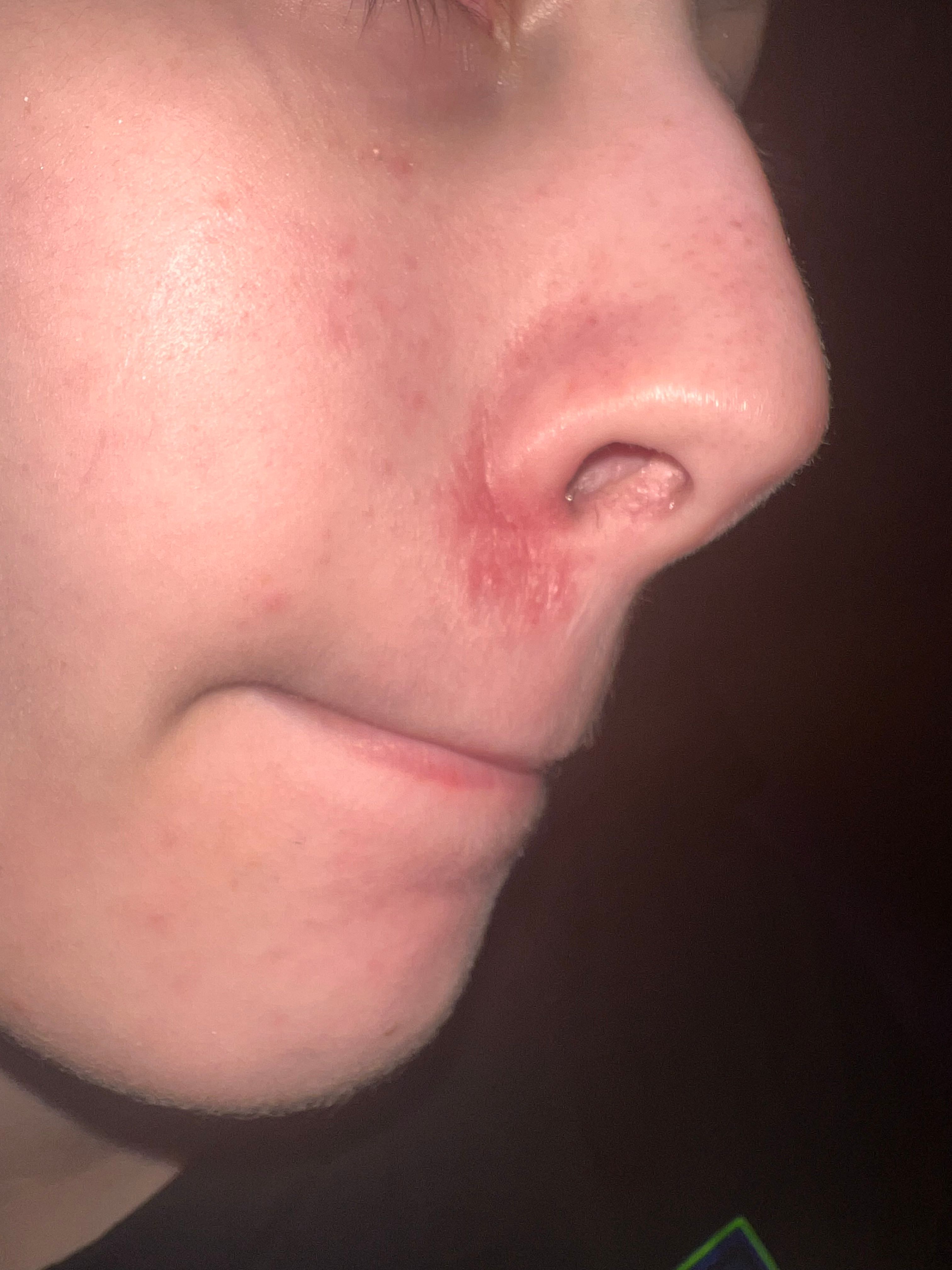 Dry flakey skin around nose - Beauty Insider Community