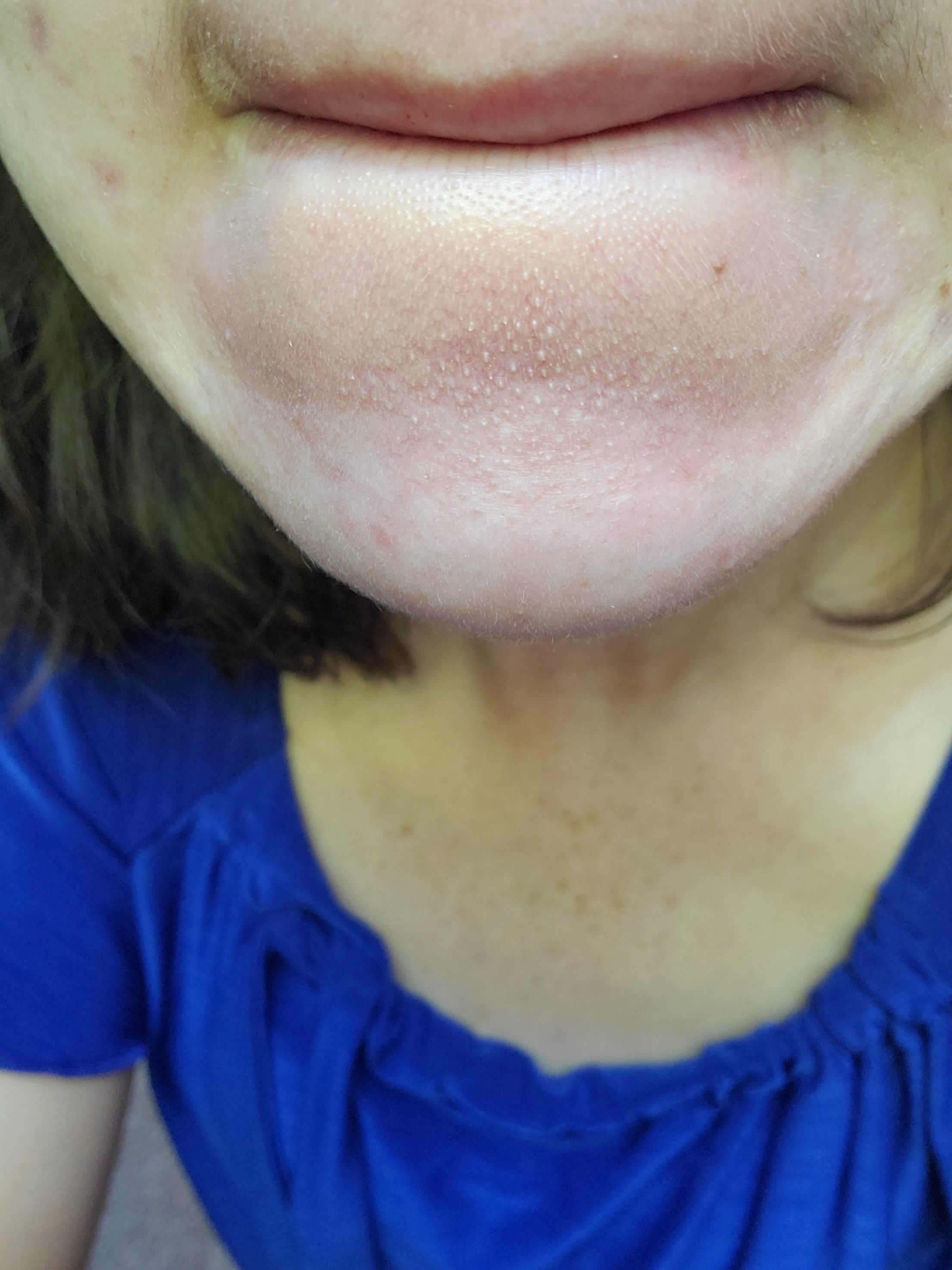 Anyone know what these bumps are in the ... - Beauty Insider Community