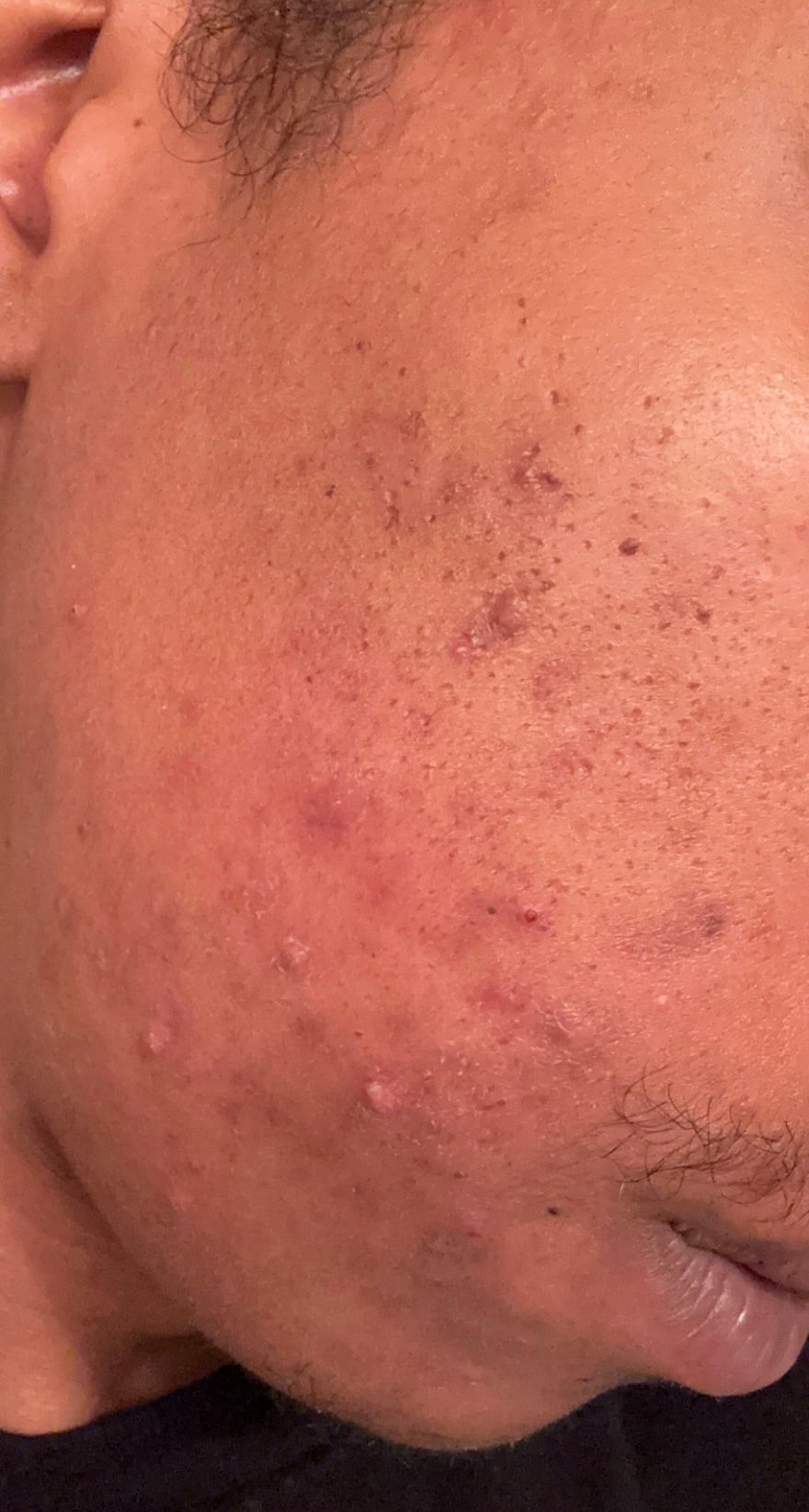 Bumps under skin and red bumps, Please h... - Beauty Insider Community