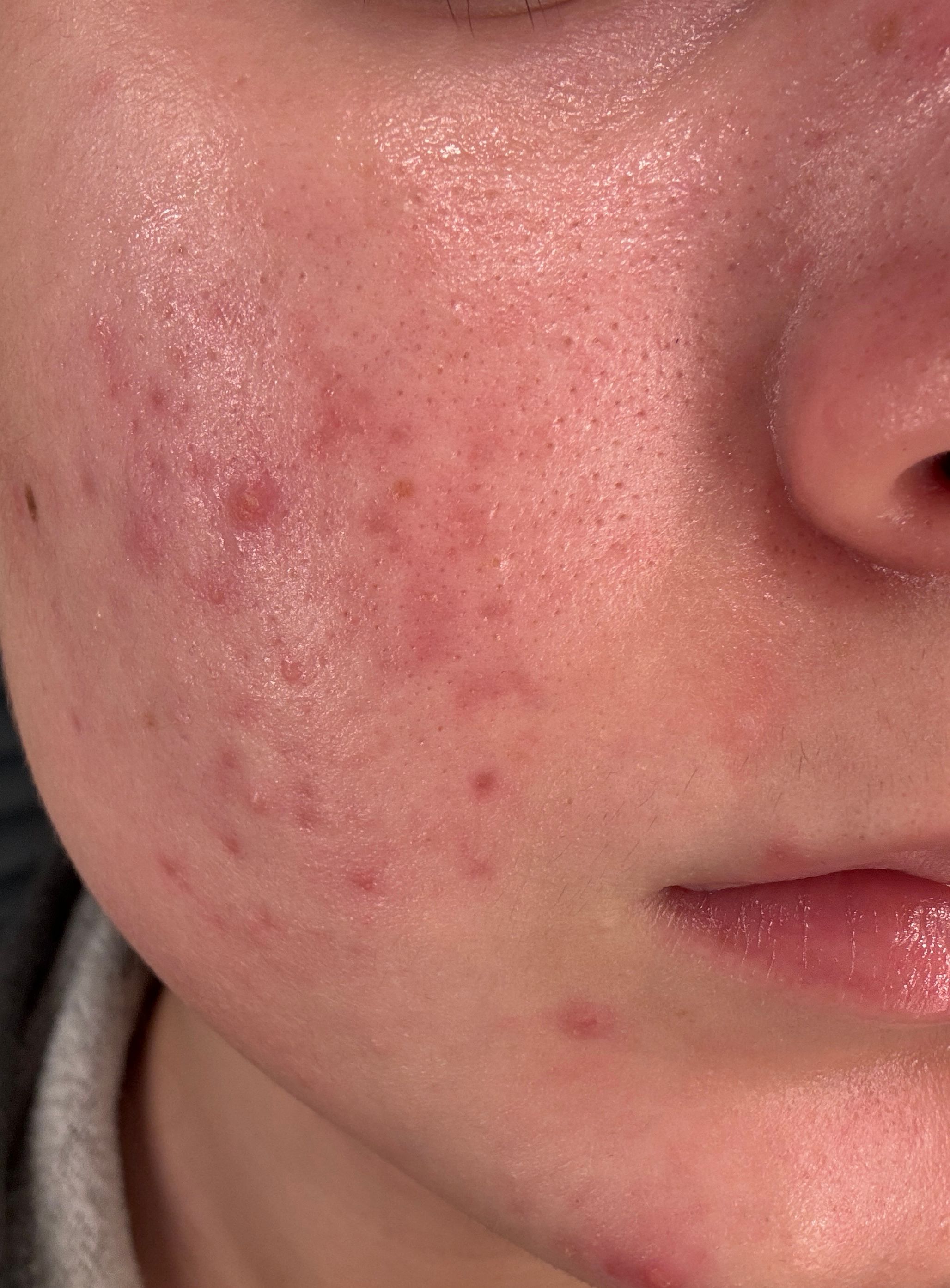 Acne help - Beauty Insider Community