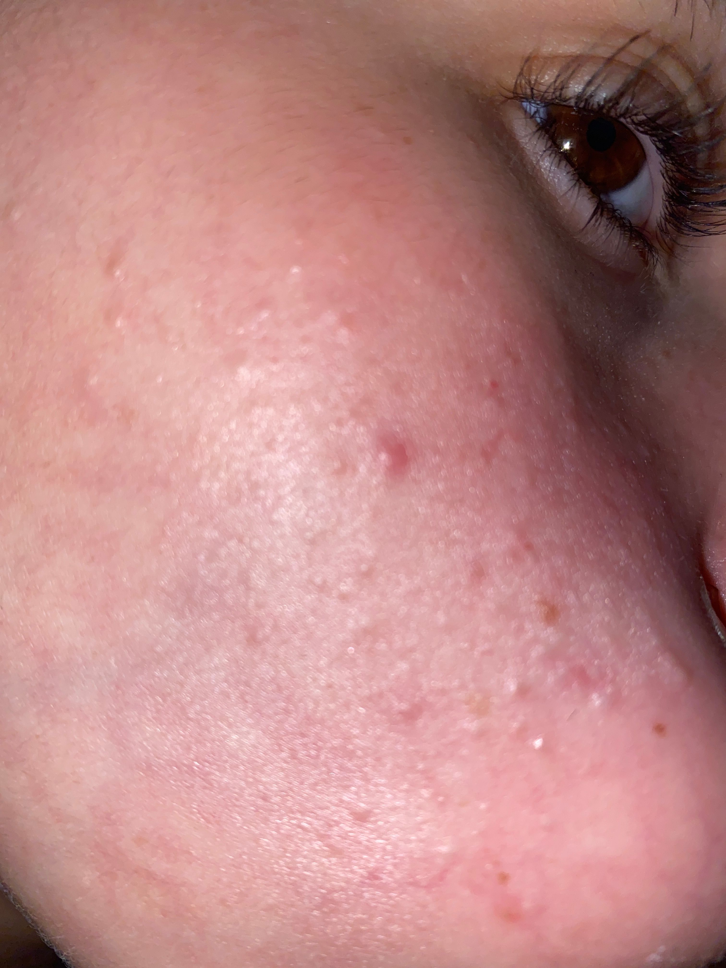 Weird white bumps - Beauty Insider Community