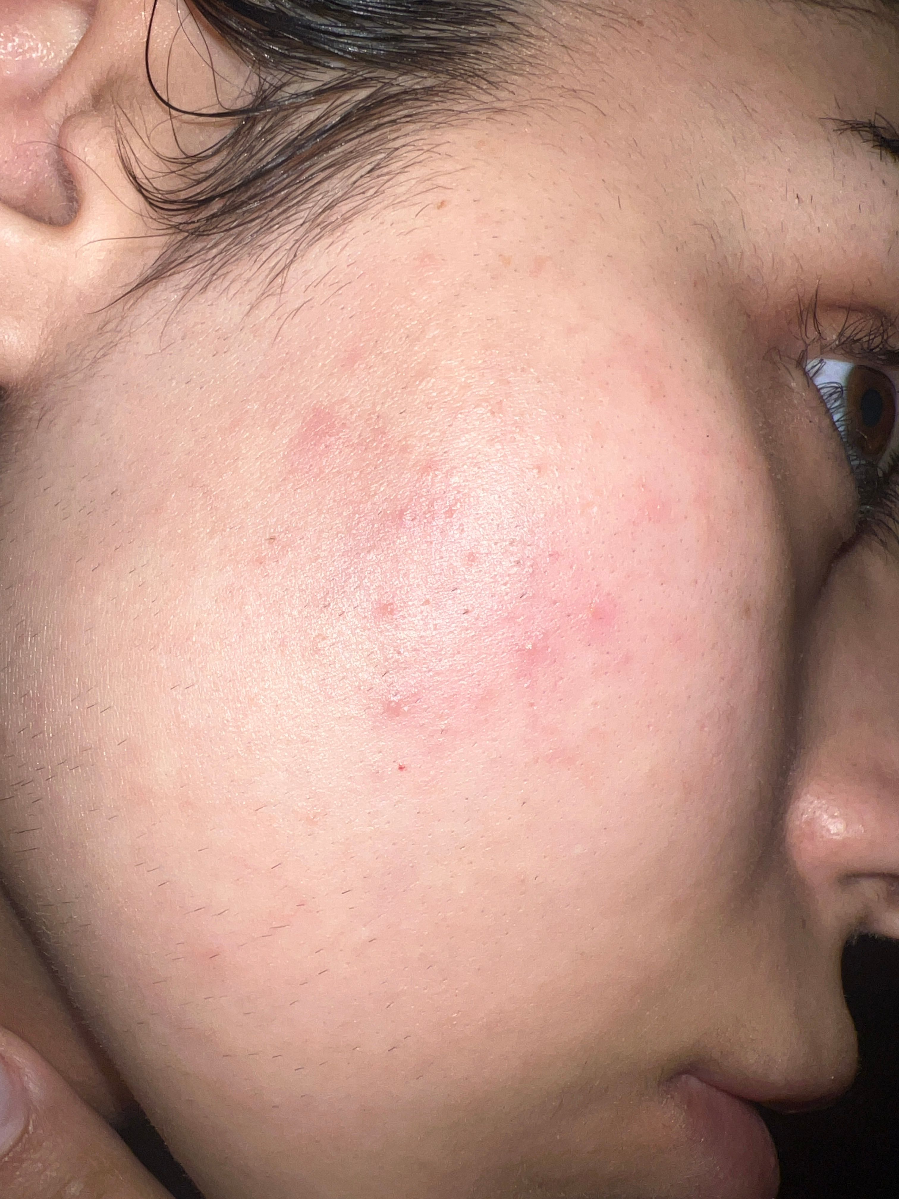 Weird rashes - Beauty Insider Community