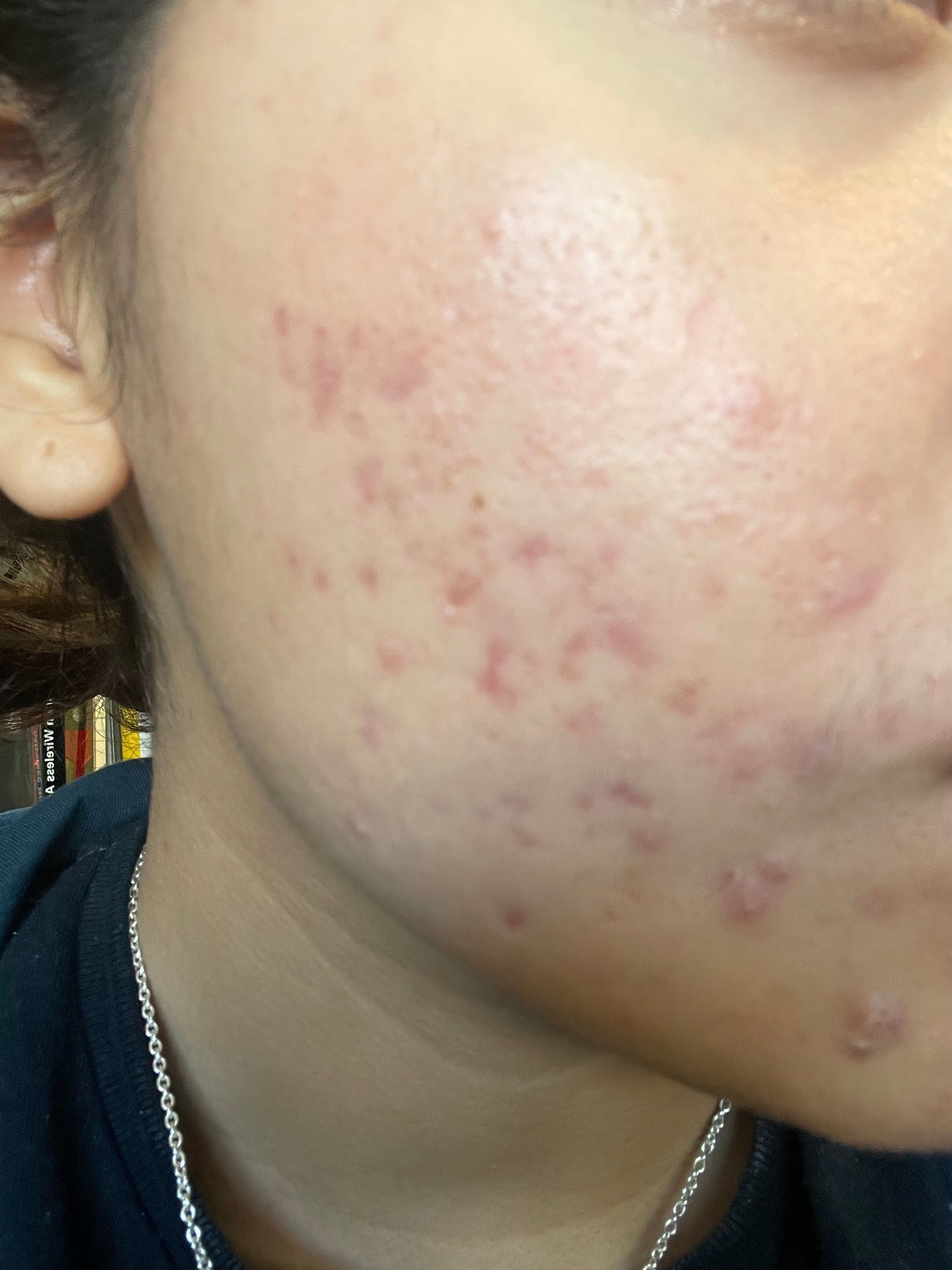 acne - Beauty Insider Community