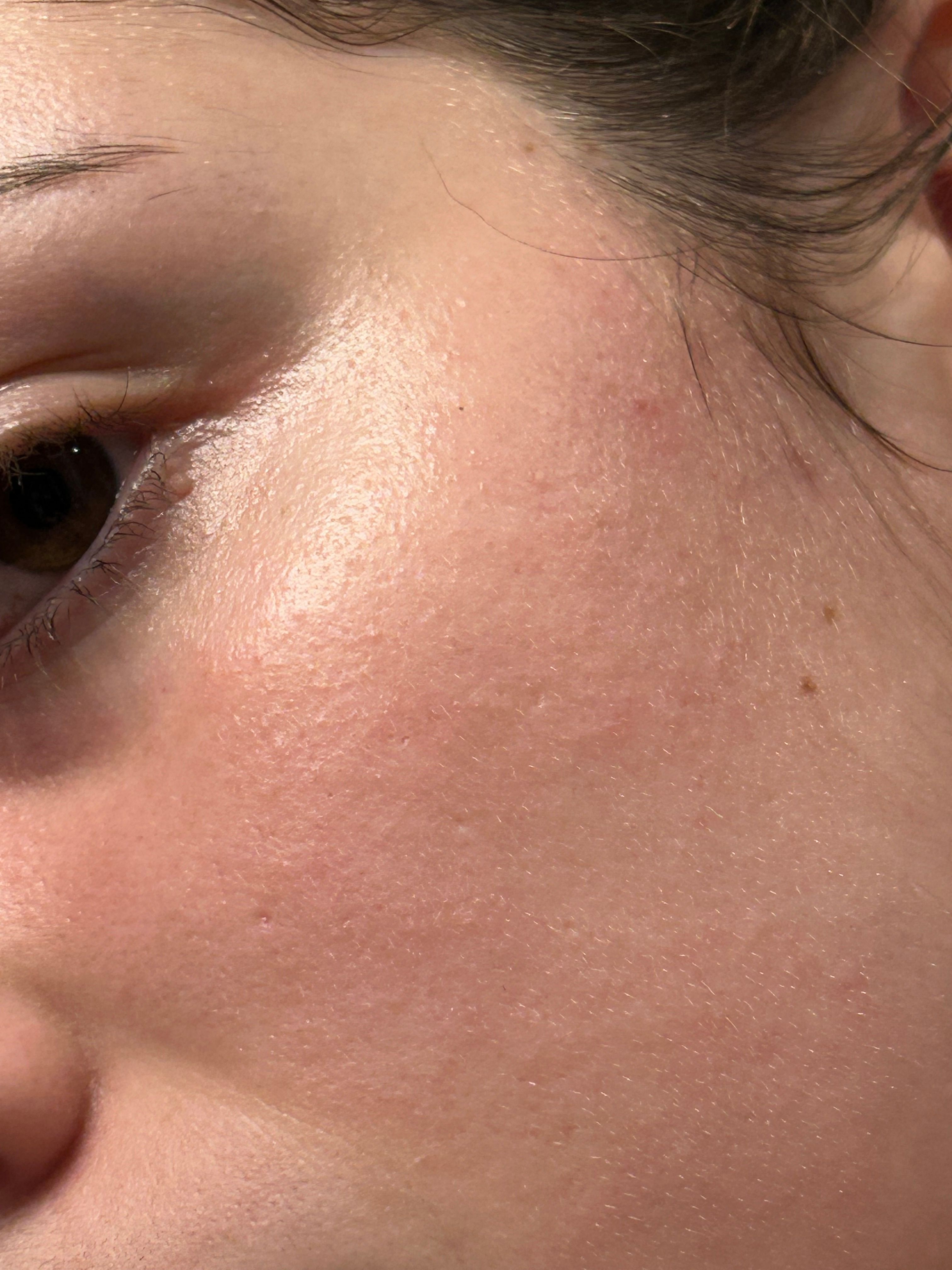 Help! Tiny itchy red bumps on face - Beauty Insider Community