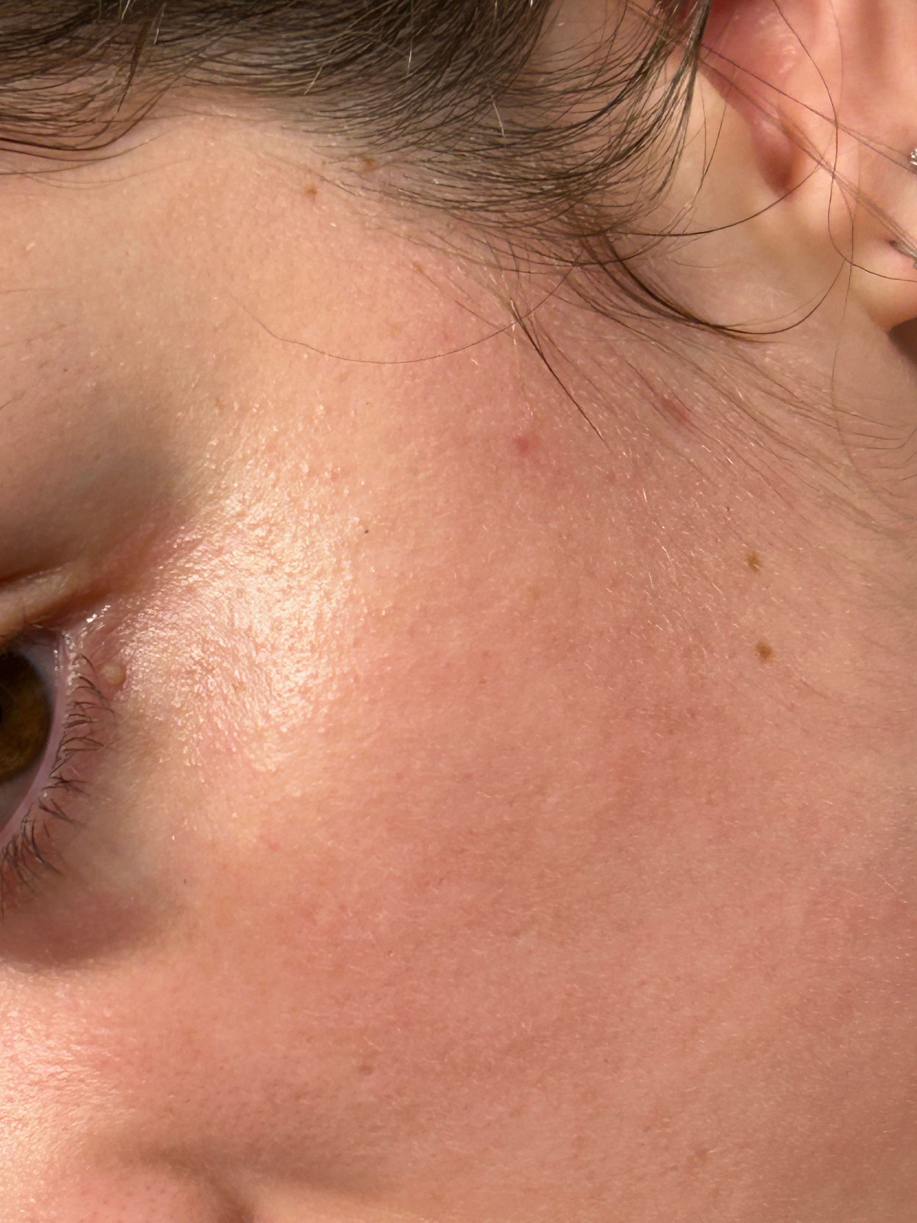 Help! Tiny itchy red bumps on face - Beauty Insider Community