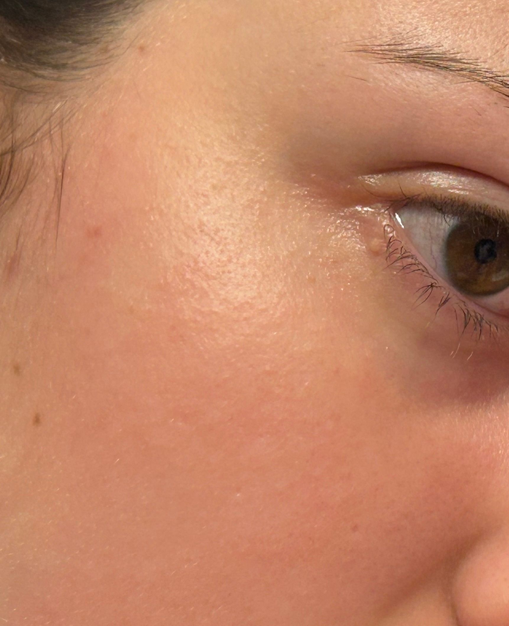 Help! Tiny itchy red bumps on face - Beauty Insider Community