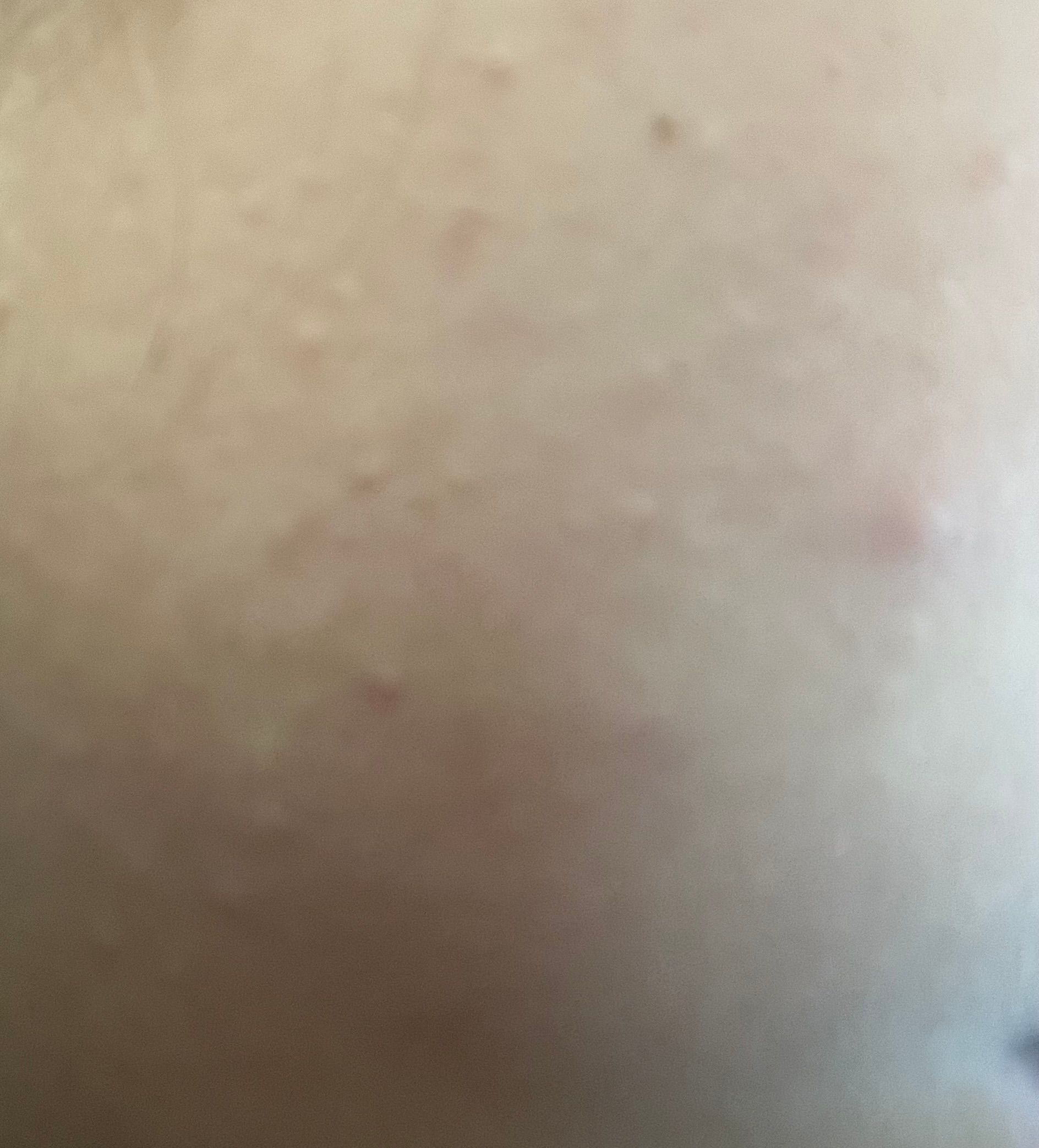 Acne - Beauty Insider Community