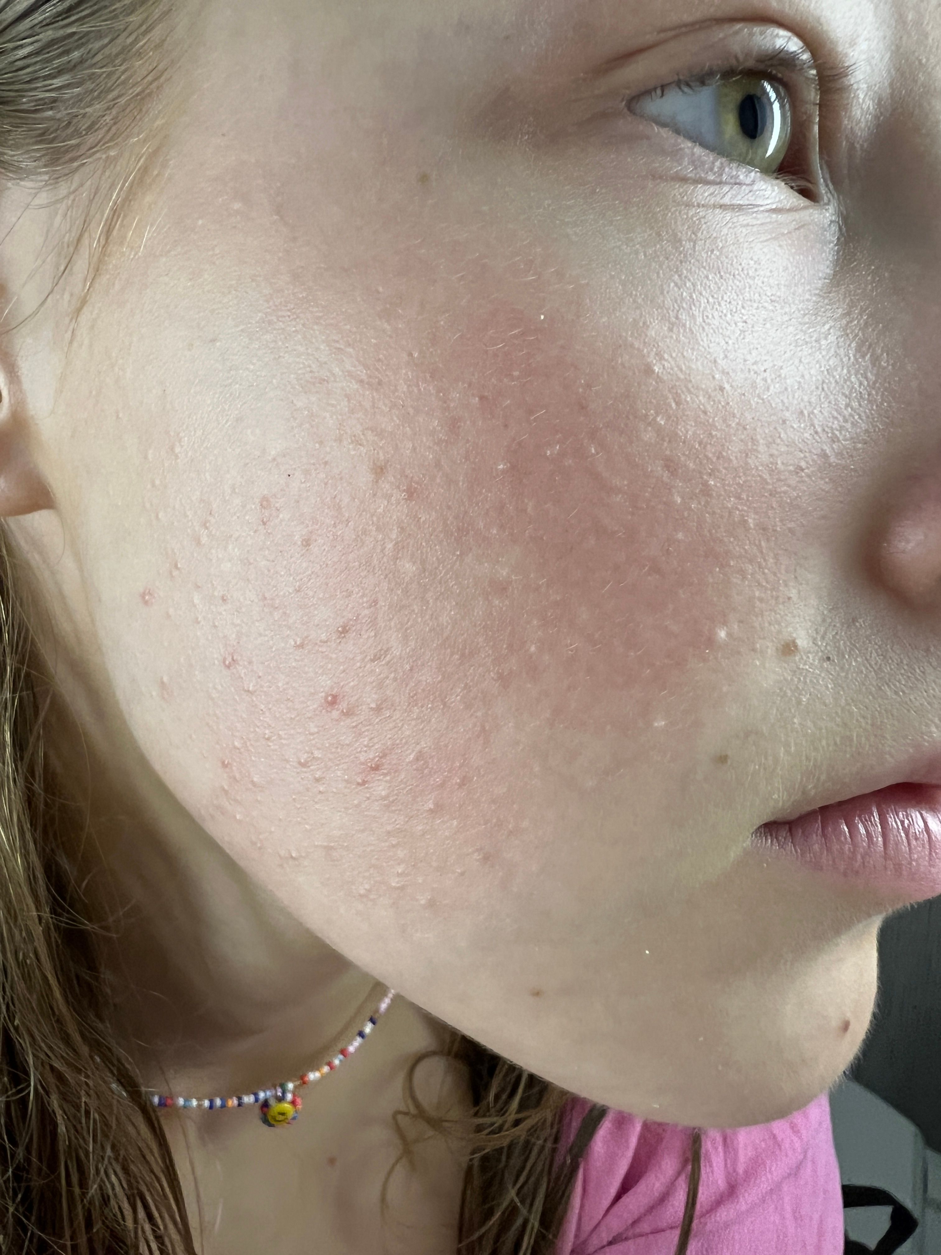 Small bumps on cheeks?? - Beauty Insider Community