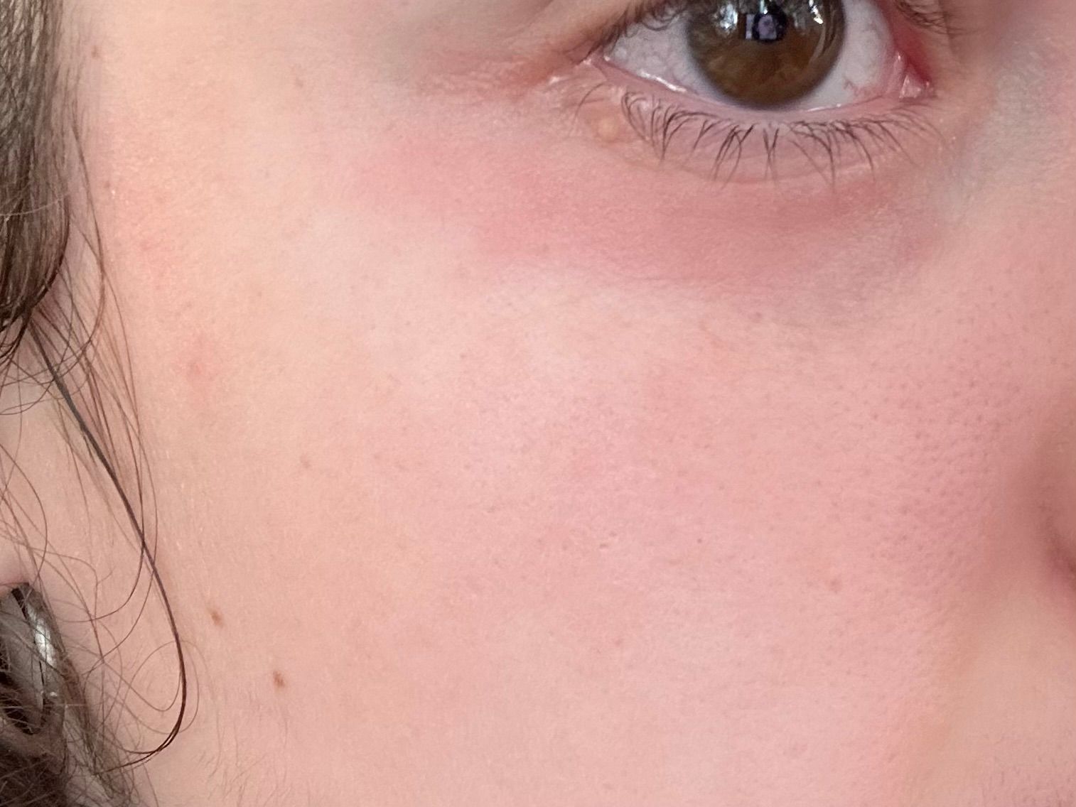 swollen, red blotchy around eye Eczema? - Beauty Insider Community