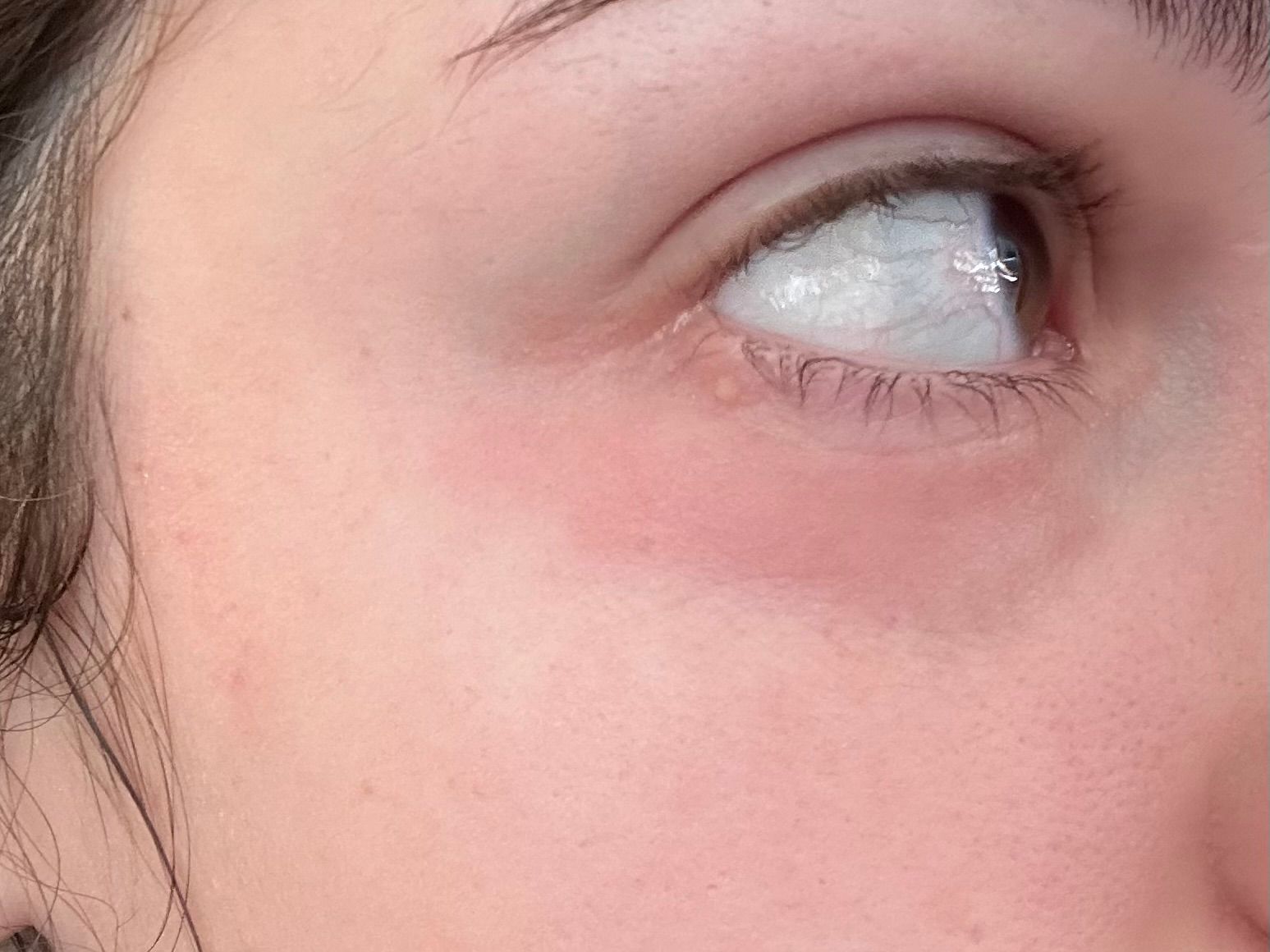 swollen, red blotchy around eye Eczema? - Beauty Insider Community