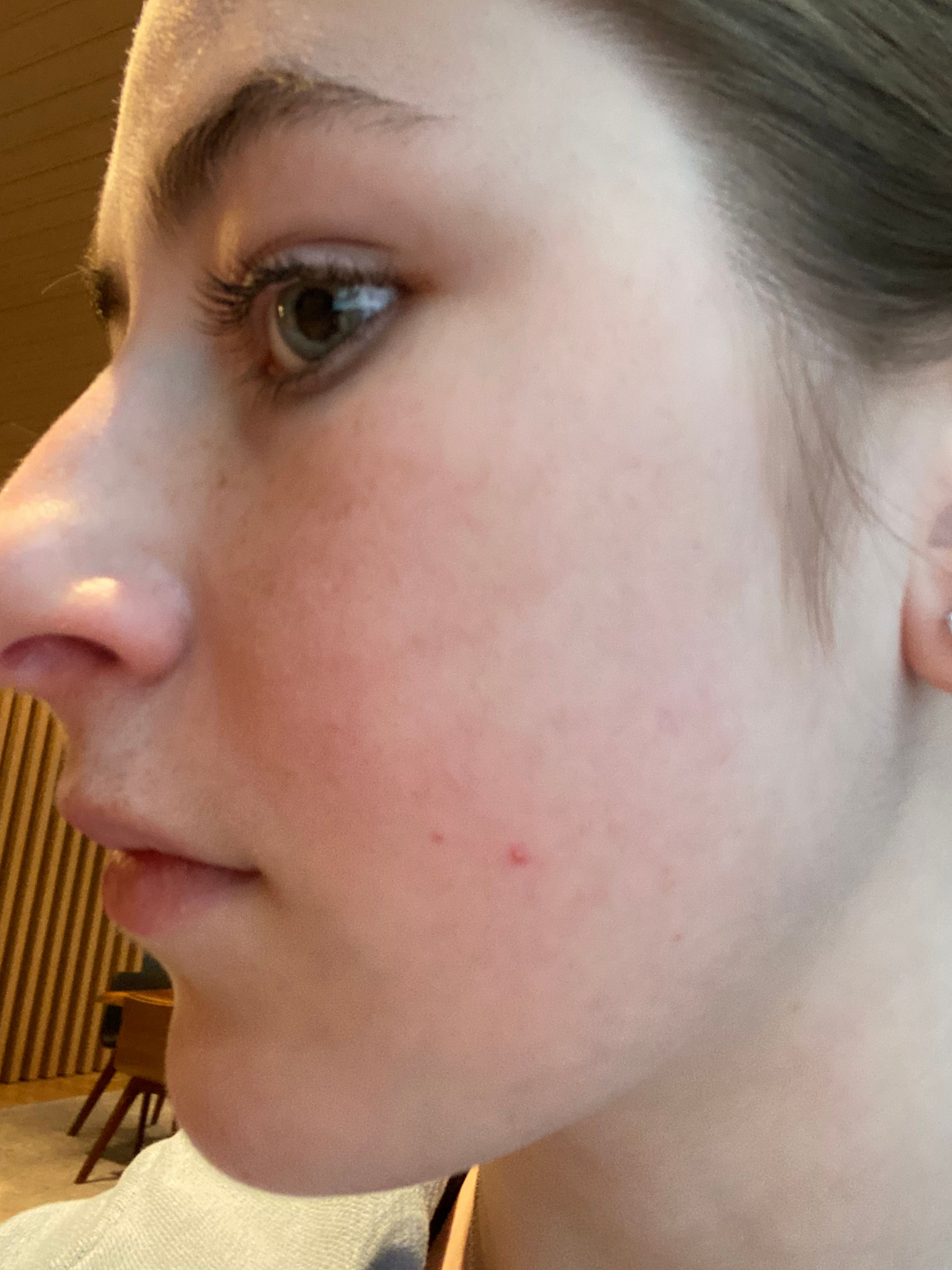Keratosis Pilaris on Face - Beauty Insider Community
