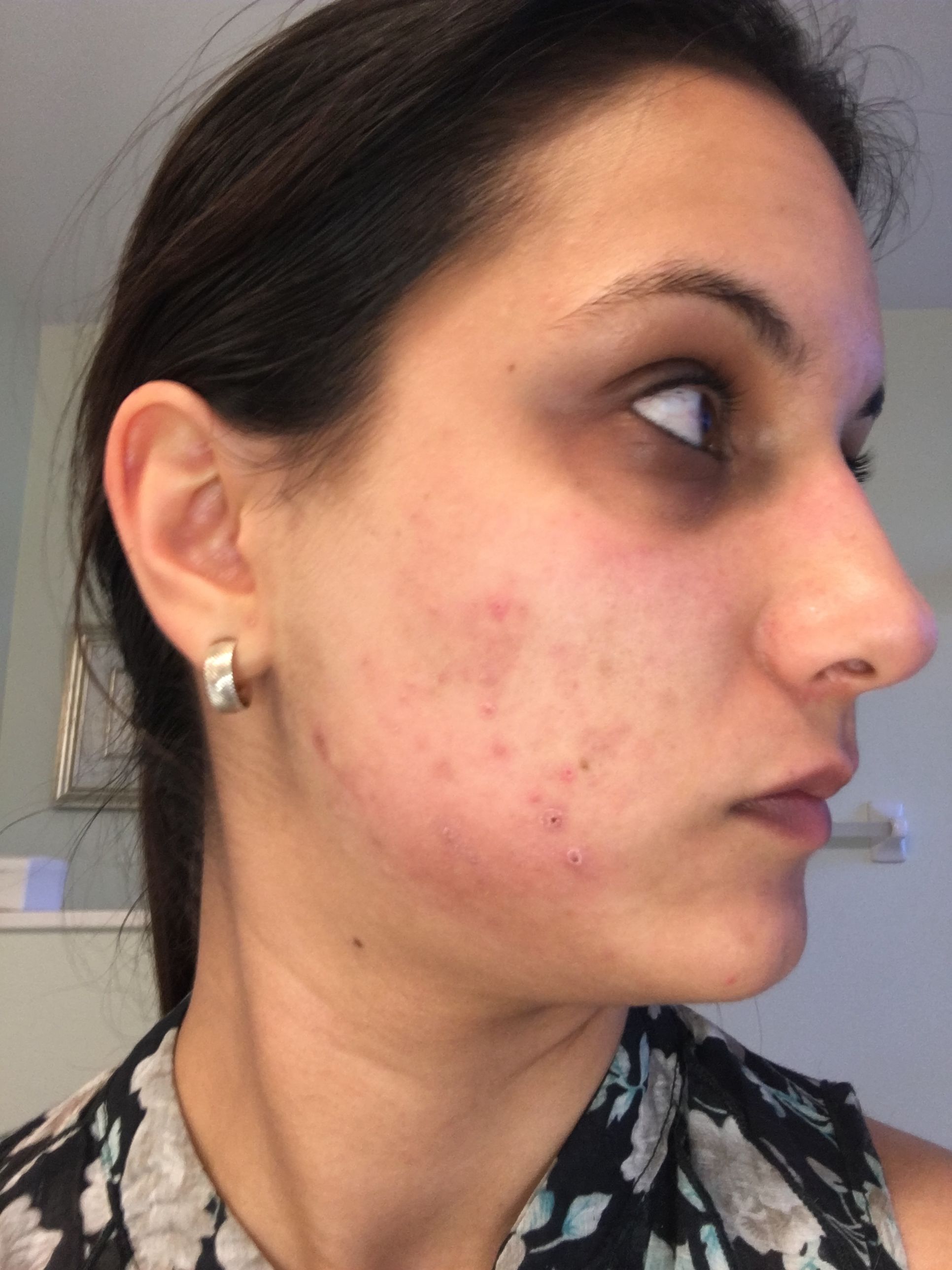 Acne Evolution - Beauty Insider Community