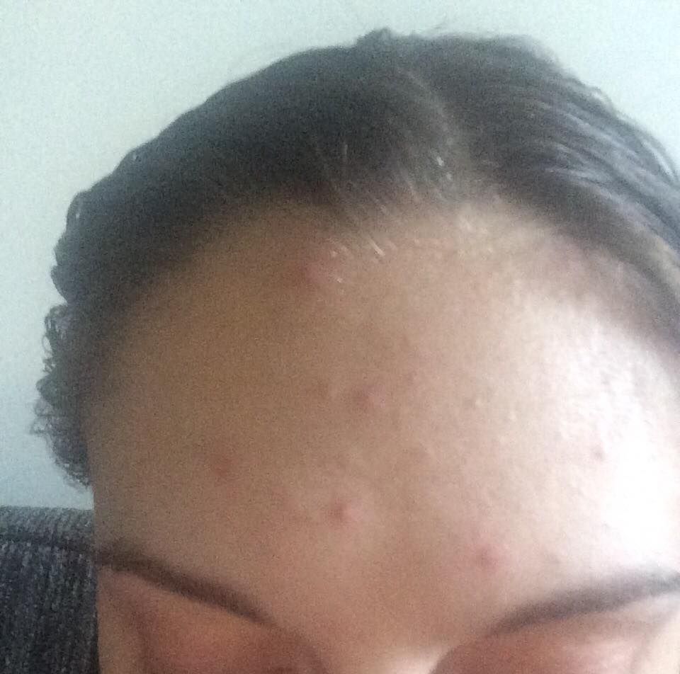 Solved: Bumps and Uneven Texture - Beauty Insider Community