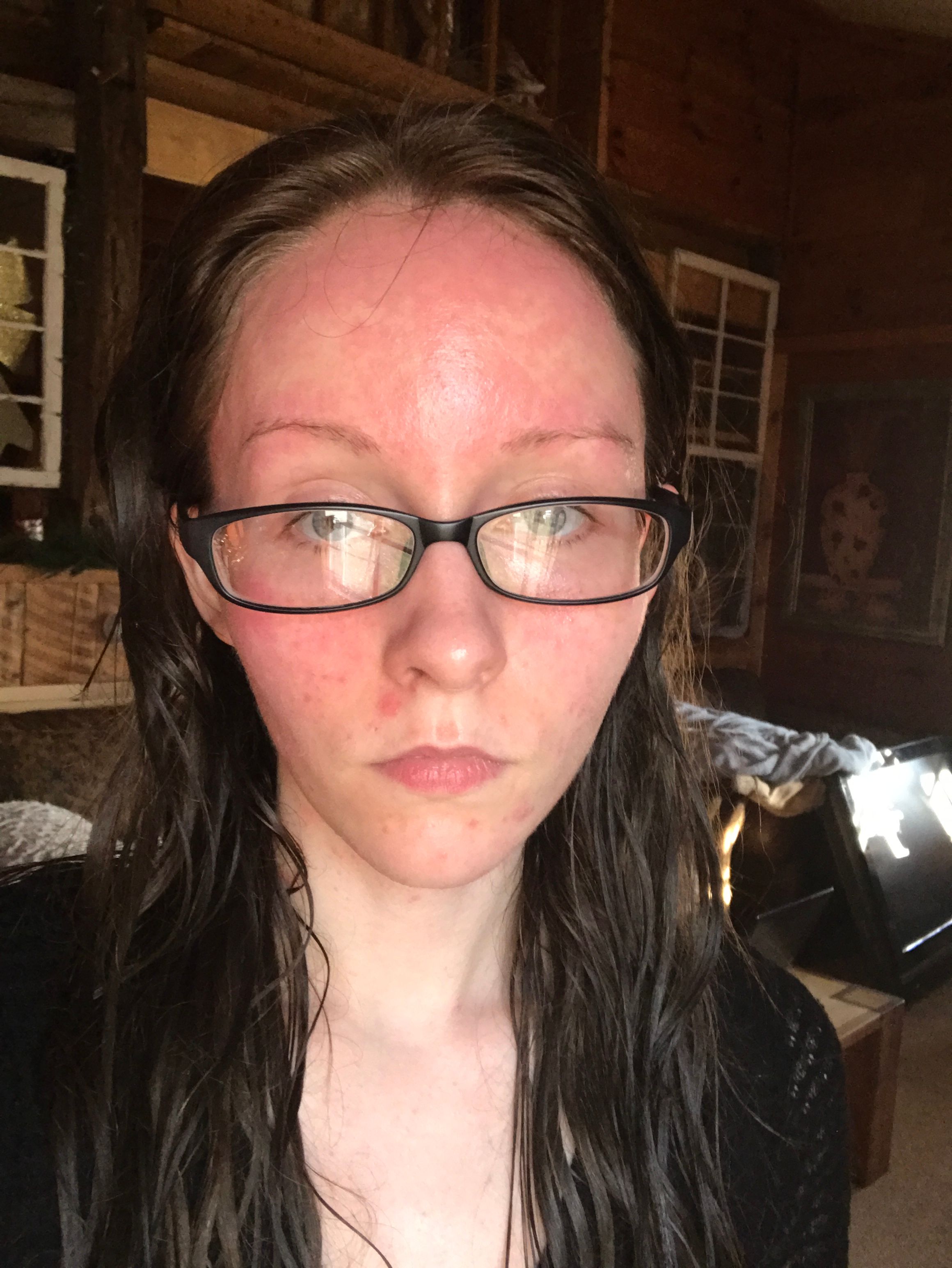 Sensitive skin or allergic reaction? - Beauty Insider Community