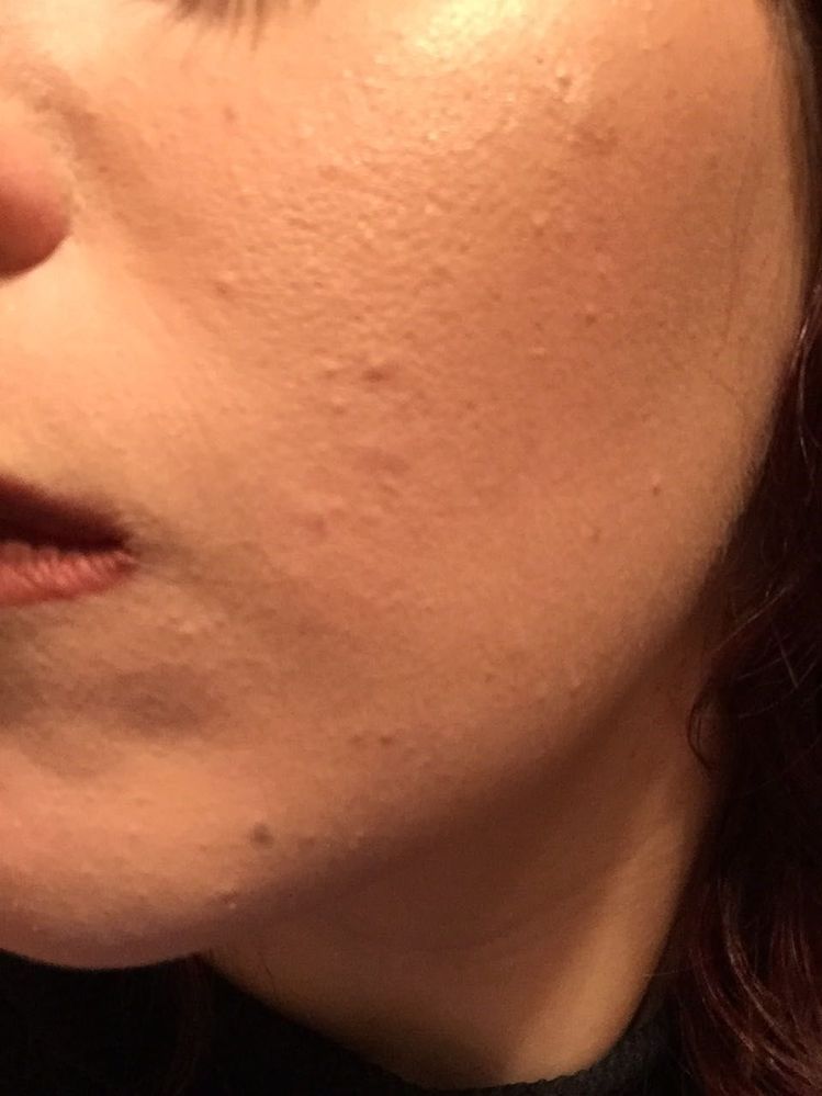 small bumps on cheeks ?? - Beauty Insider Community